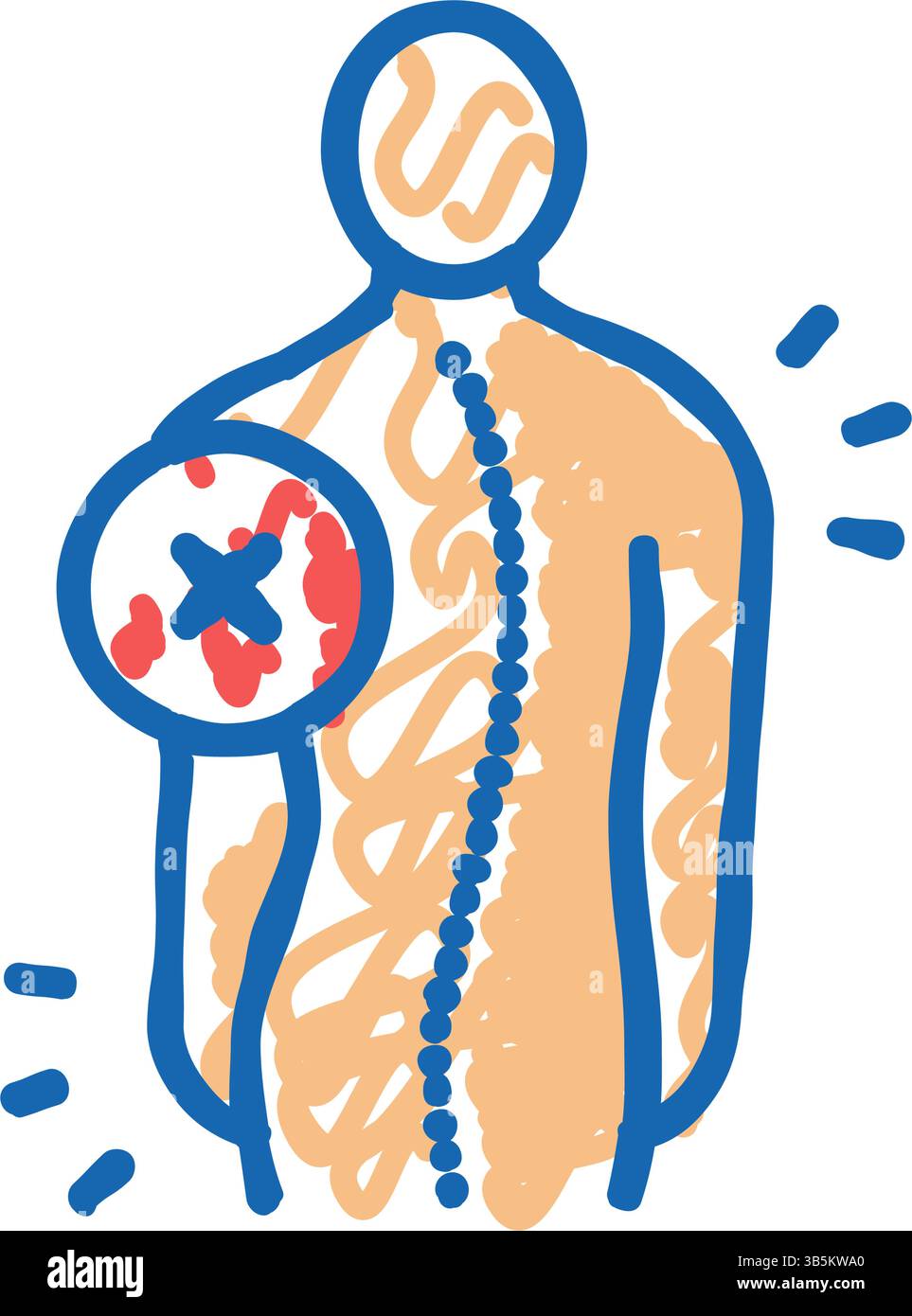 idiopathic scoliosis icon doodle illustration Stock Vector Image & Art ...