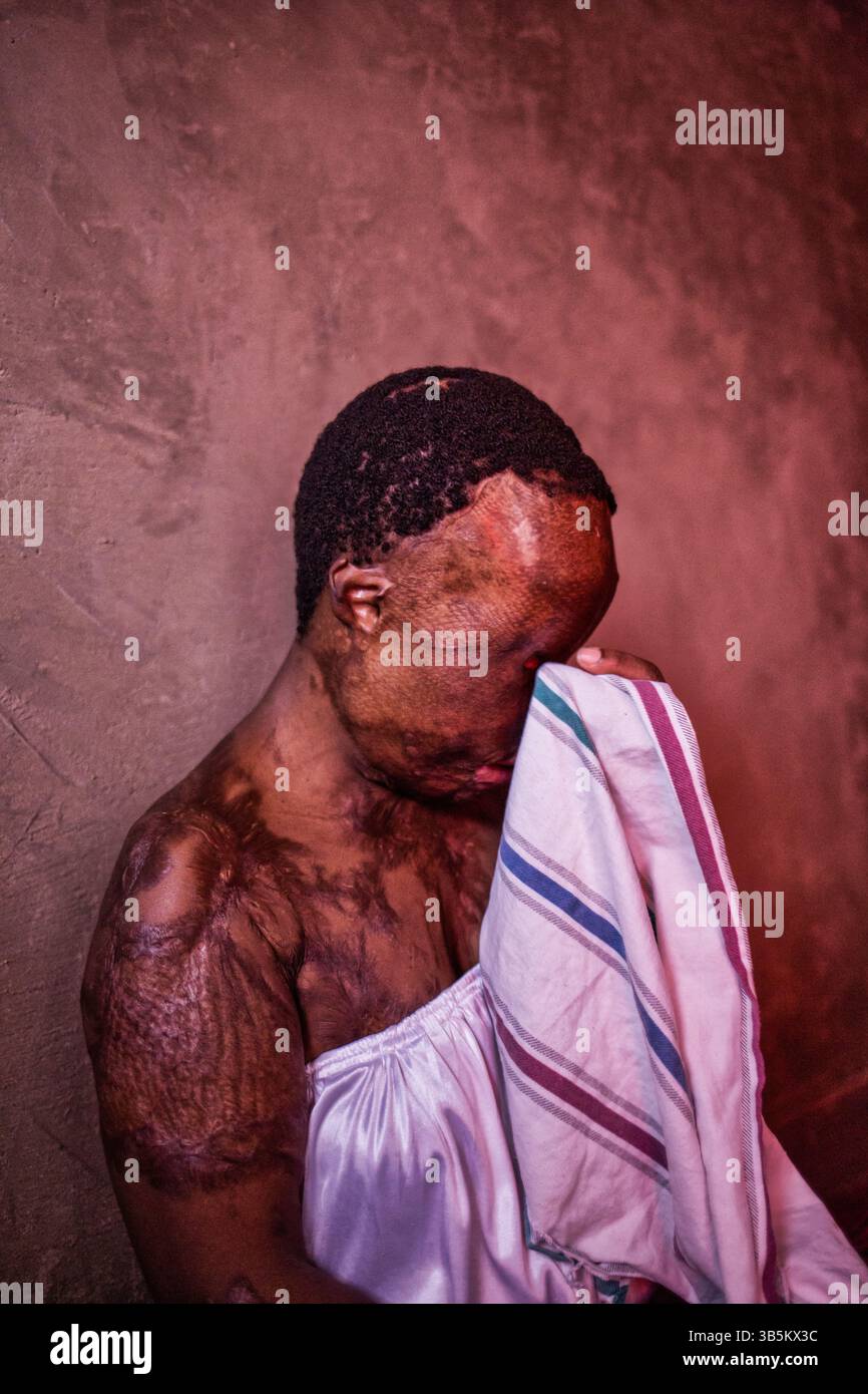 Acid attack survivors in Uganda, Africa Stock Photo - Alamy
