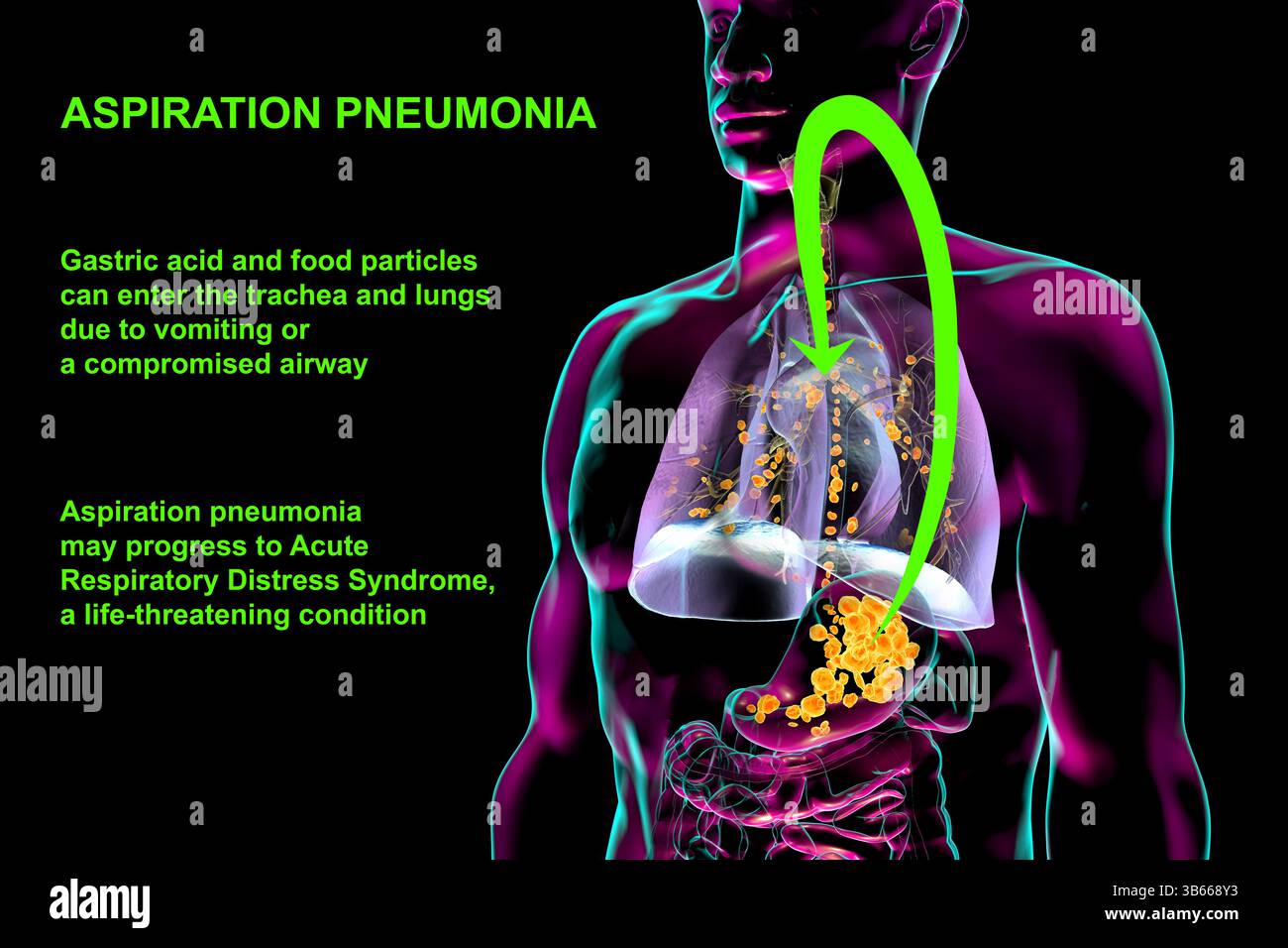 Illustration of aspiration pneumonia, showing how gastric acid and food ...