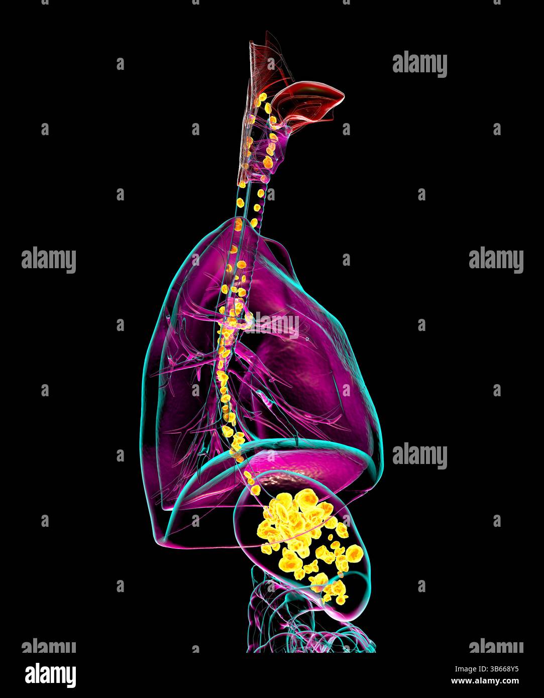 Illustration of aspiration pneumonia, showing how gastric acid and food ...