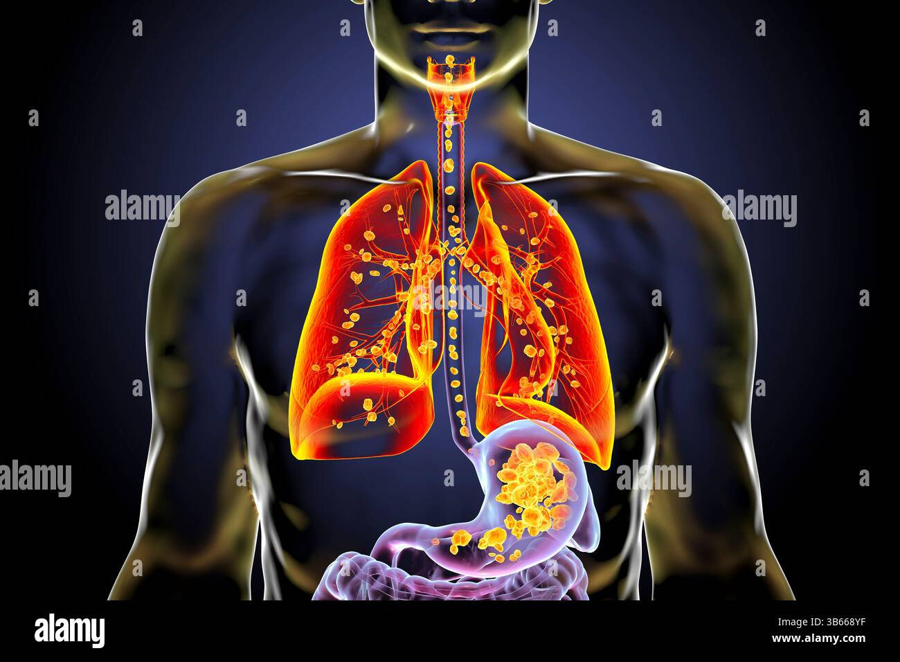 Illustration of aspiration pneumonia, showing how gastric acid and food ...