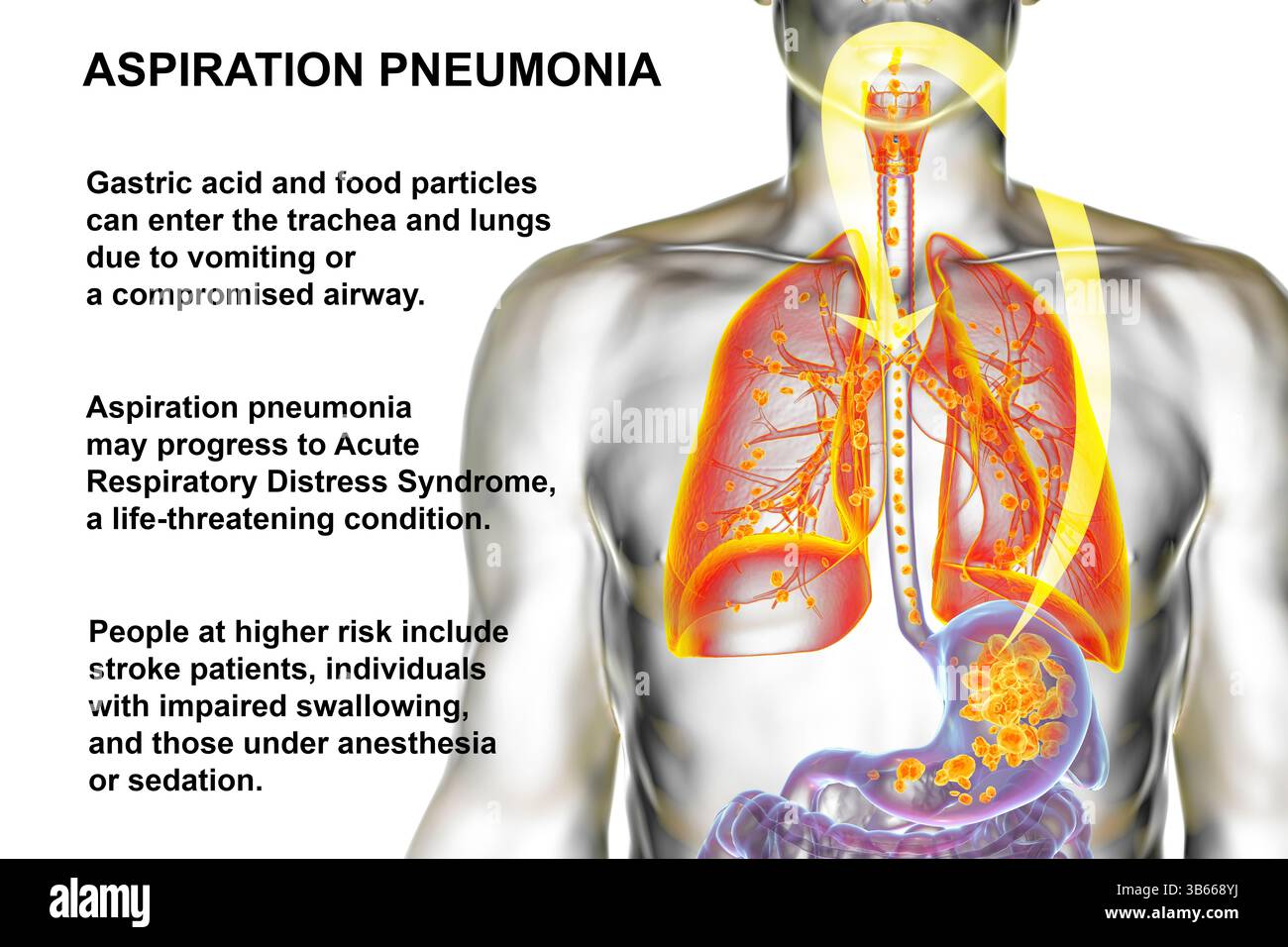 Illustration of aspiration pneumonia, showing how gastric acid and food ...