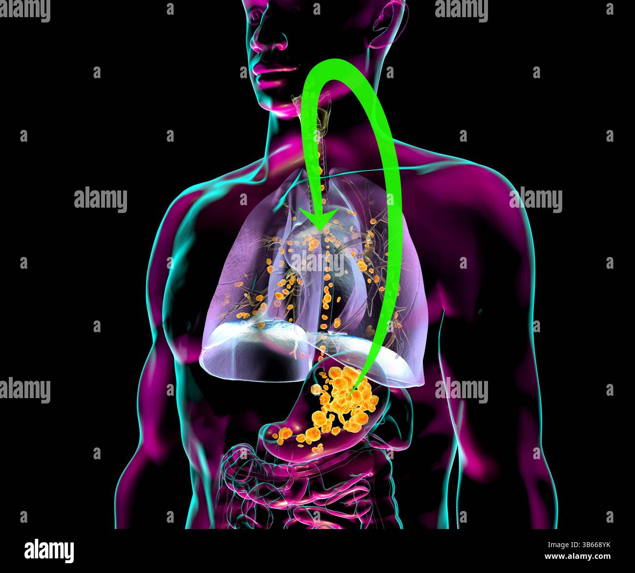 Illustration of aspiration pneumonia, showing how gastric acid and food ...
