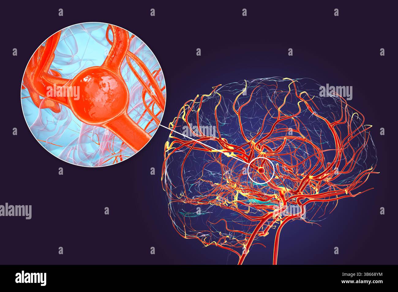 Illustration of a saccular (berry) aneurysm on the brain middle ...