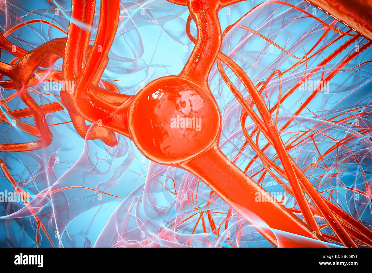Illustration of a saccular (berry) aneurysm on a brain artery ...
