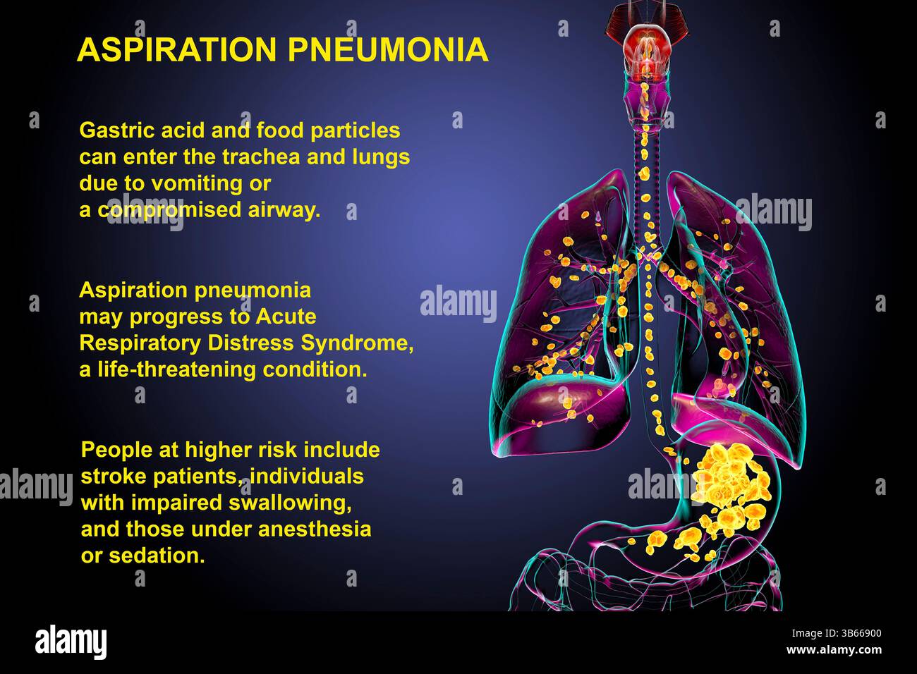 Illustration of aspiration pneumonia, showing how gastric acid and food ...