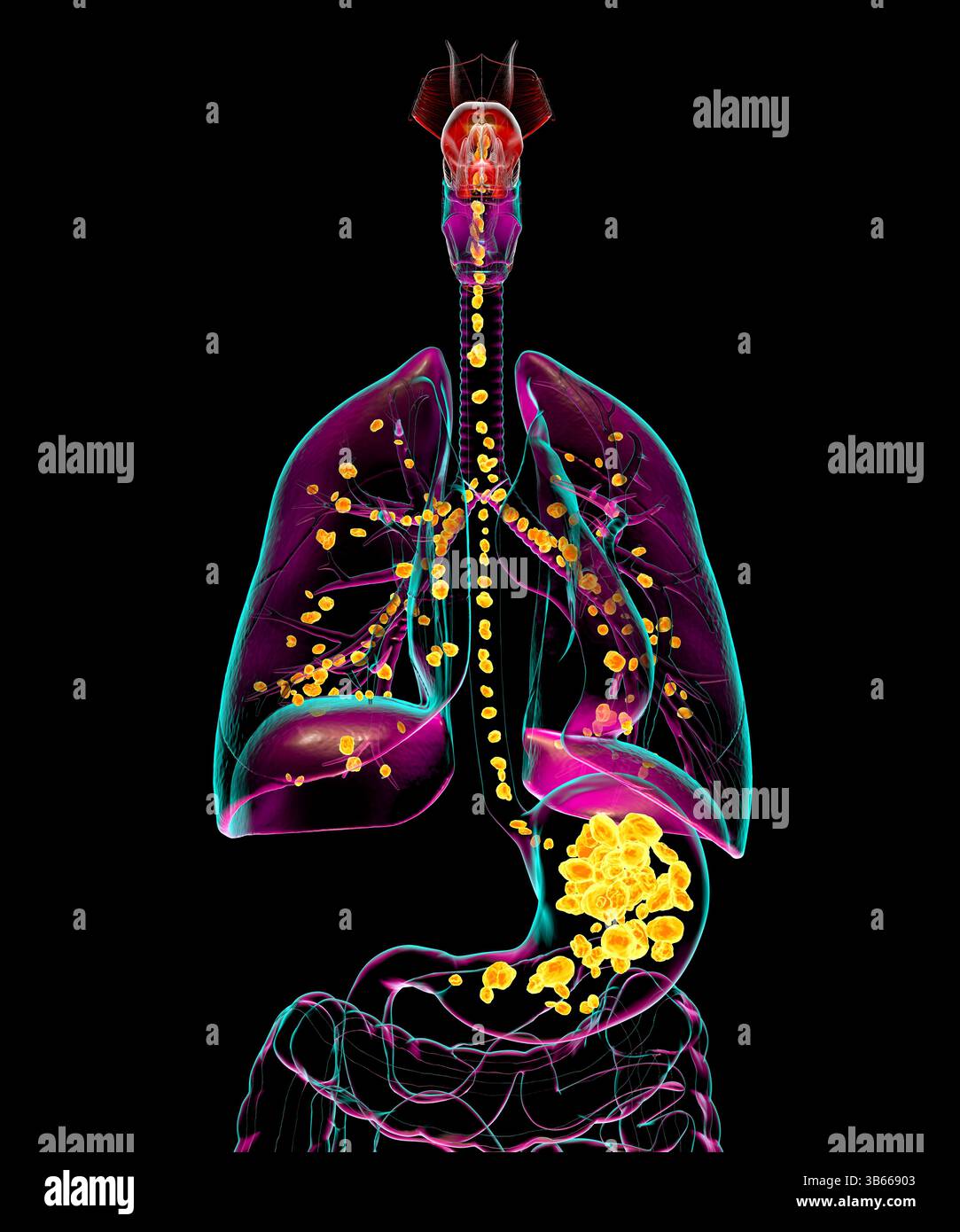 Illustration of aspiration pneumonia, showing how gastric acid and food ...