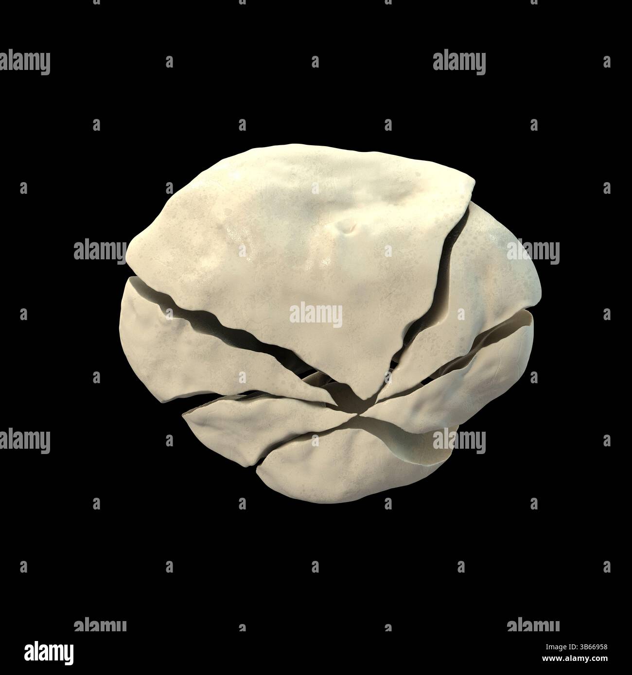 Illustration of a patella multifragmented displaced fracture, showing multiple broken kneecap ...