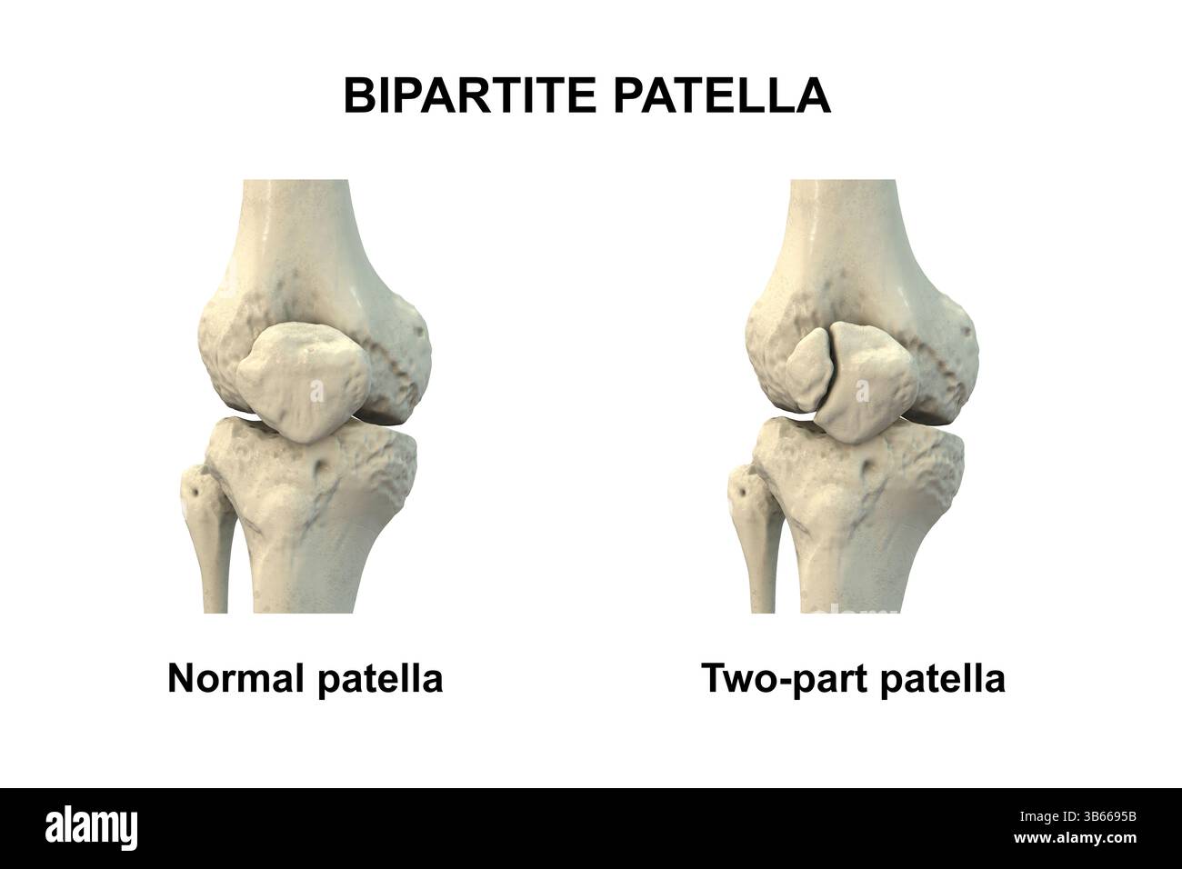 Illustration of a bipartite patella (right) and normal patella (left ...