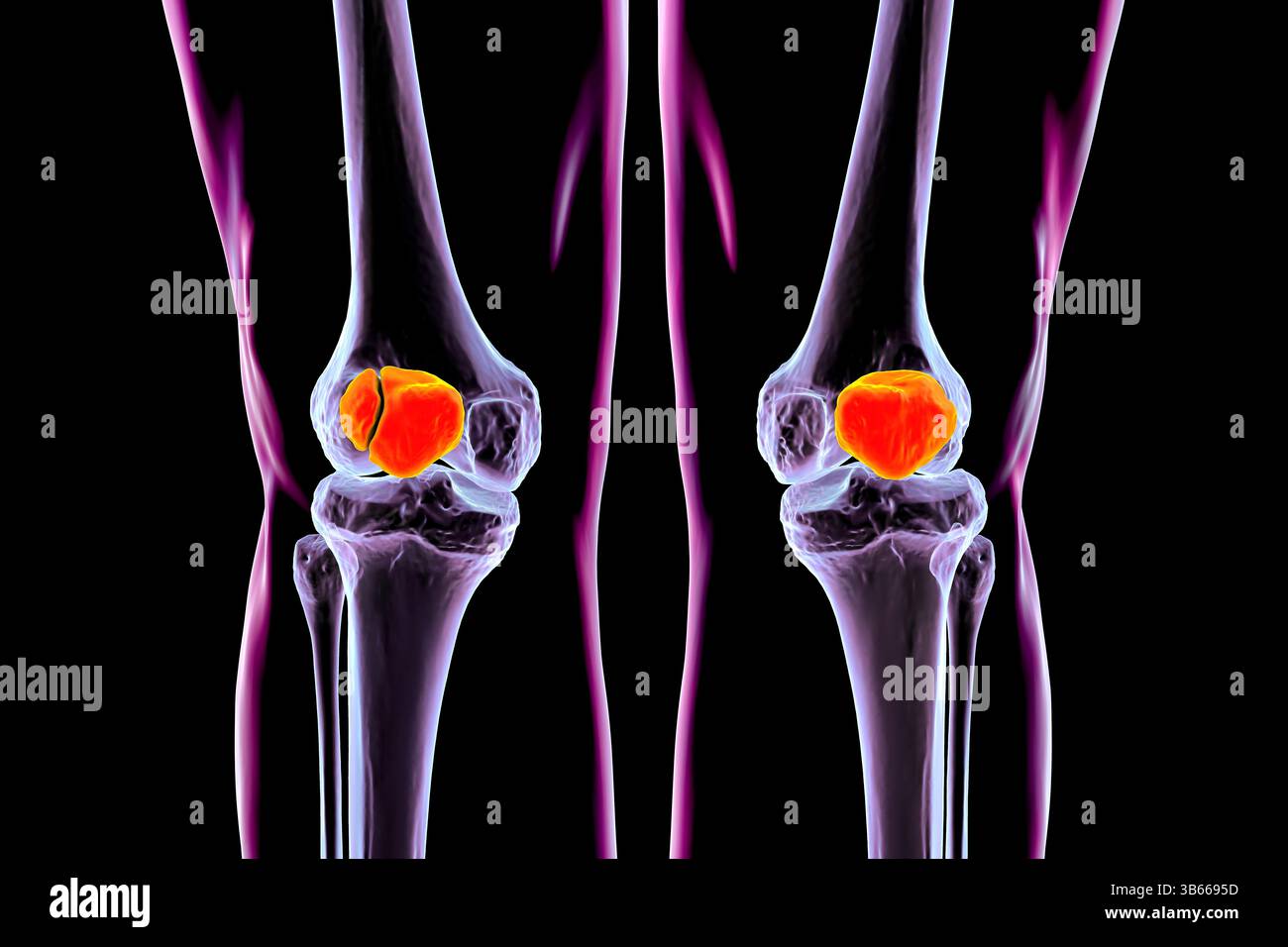 Illustration of a bipartite patella. This a condition where the kneecap ...