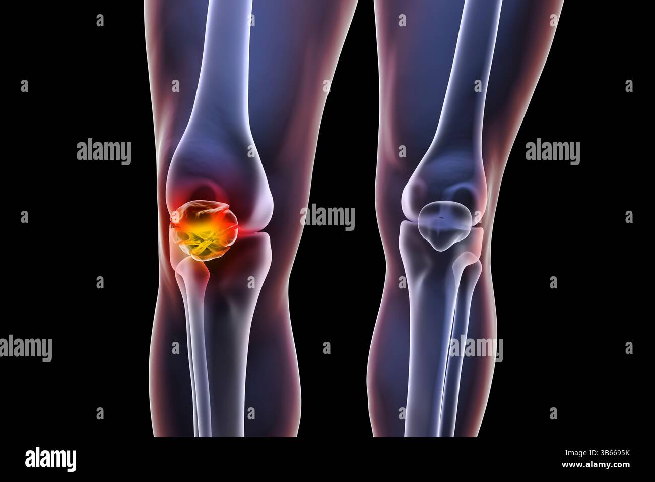 Illustration of a patella multifragmented displaced fracture, showing ...
