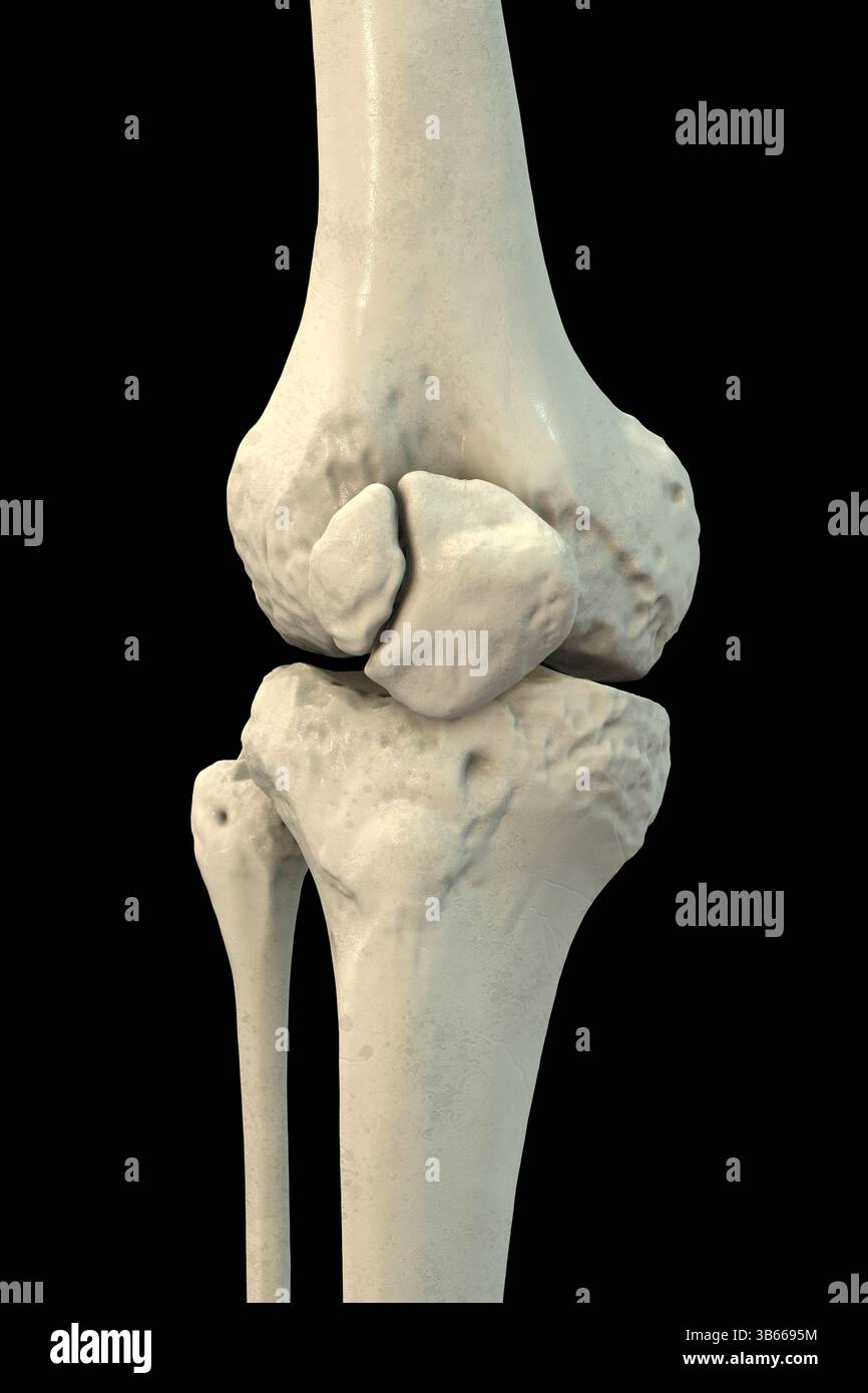 Illustration of a bipartite patella. This a condition where the kneecap ...