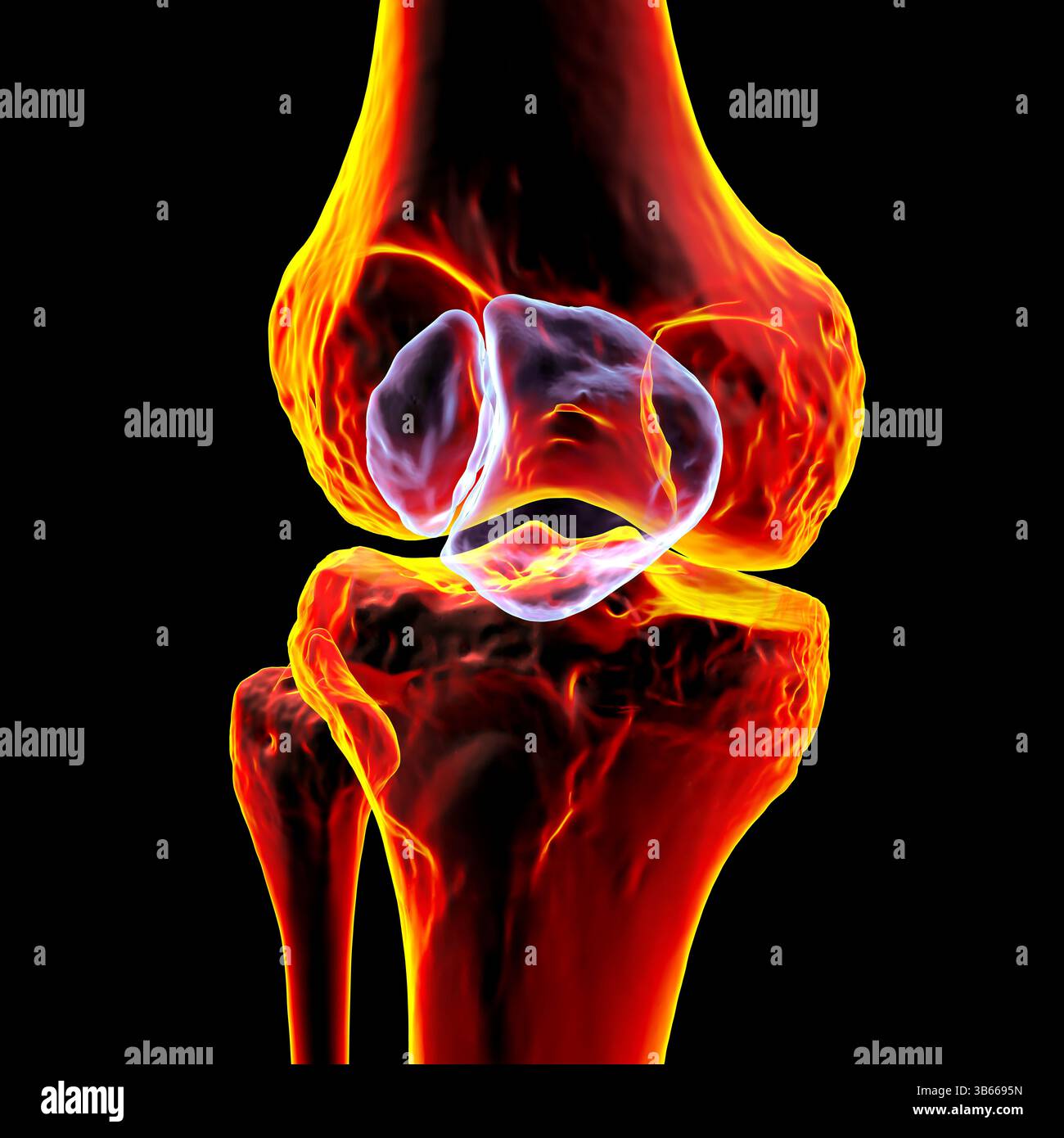 Illustration of a bipartite patella. This a condition where the kneecap ...
