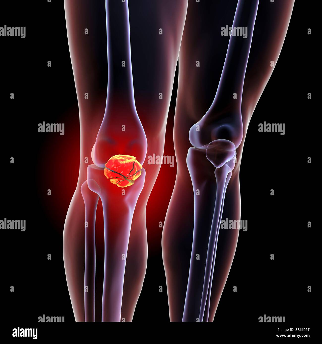 Illustration of a patella multifragmented displaced fracture, showing multiple broken kneecap ...