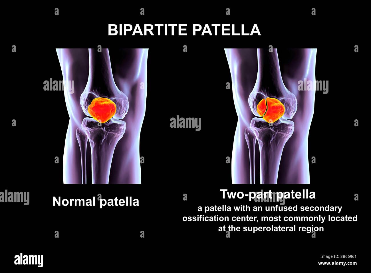Illustration of a bipartite patella (right) and normal patella (left ...