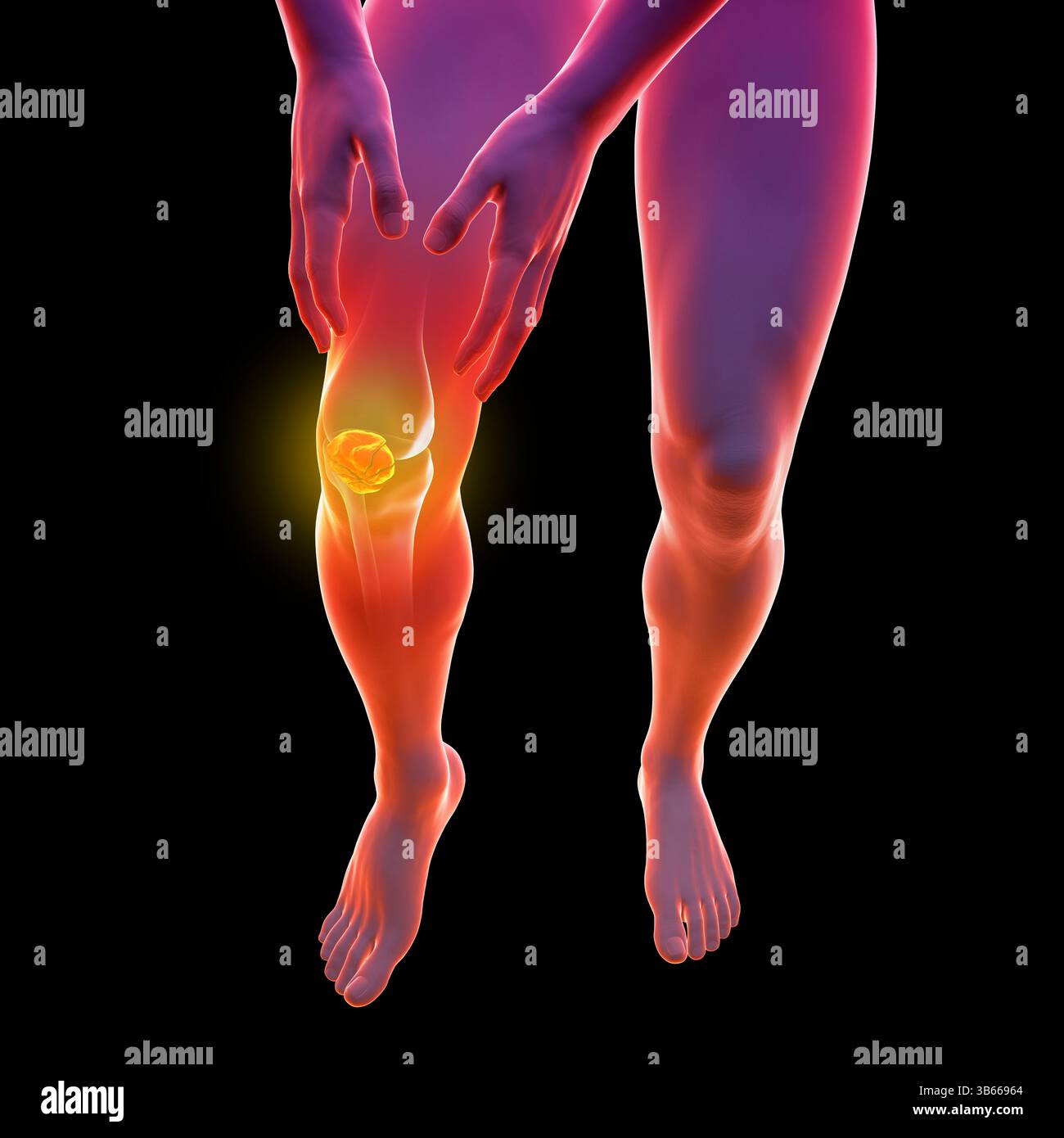 Illustration of a patella multifragmented displaced fracture, showing multiple broken kneecap ...