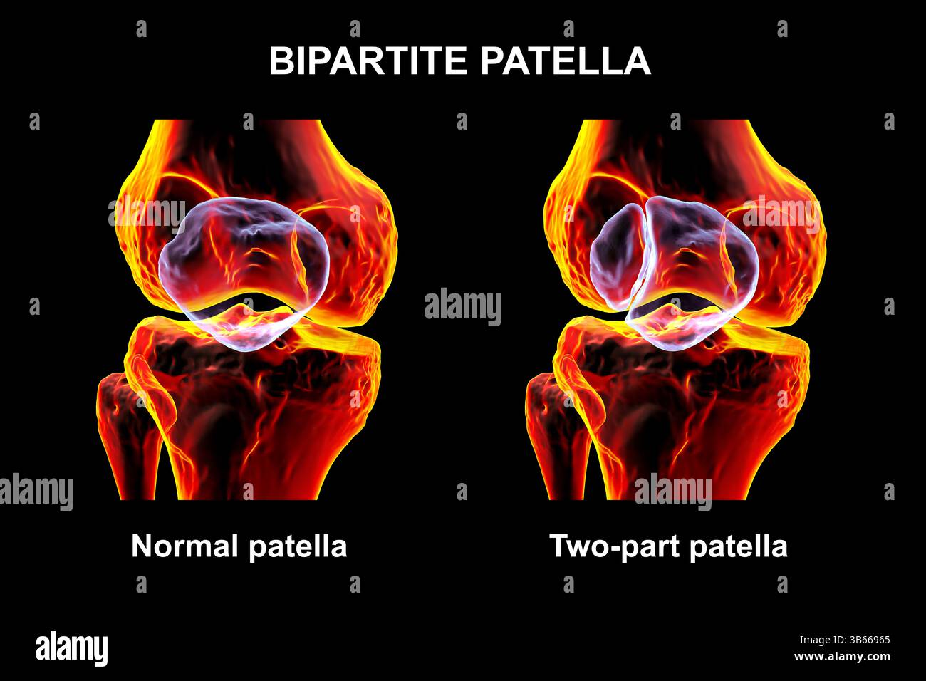 Illustration of a bipartite patella (right) and normal patella (left ...