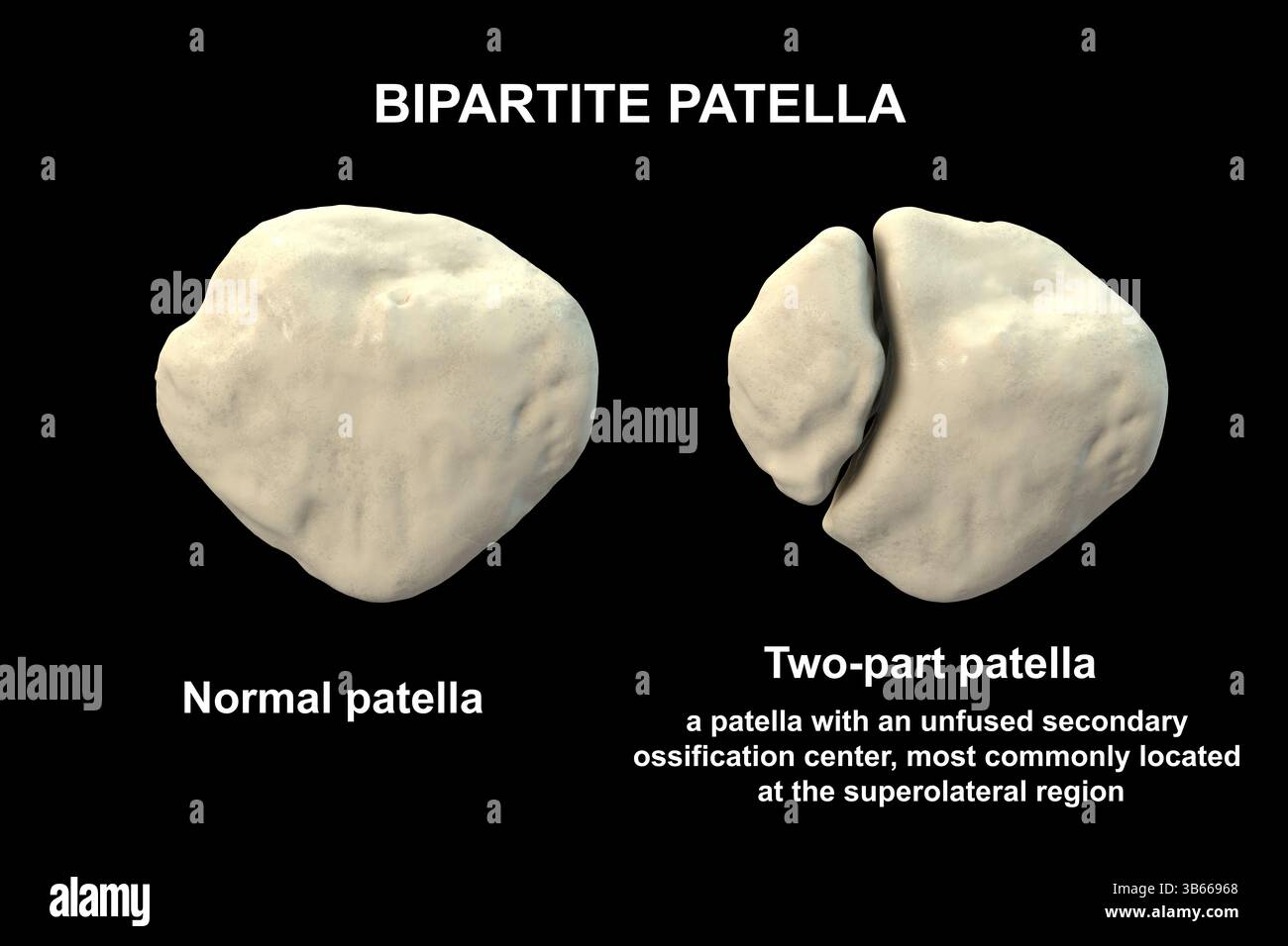 Illustration of a bipartite patella (right) and normal patella (left ...
