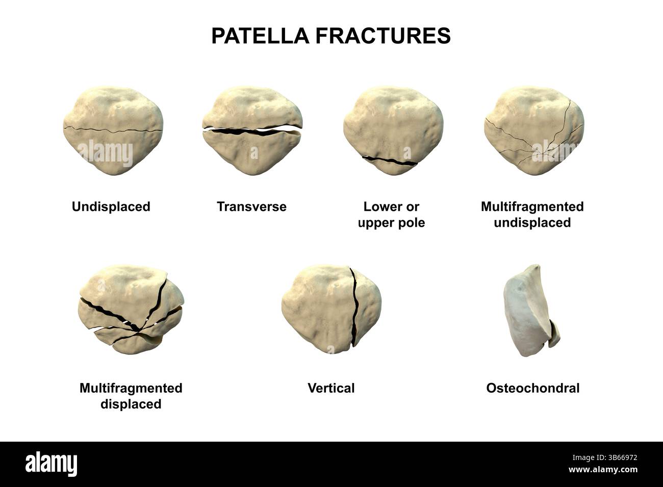 Illustration showing of various patella fractures Stock Photo - Alamy