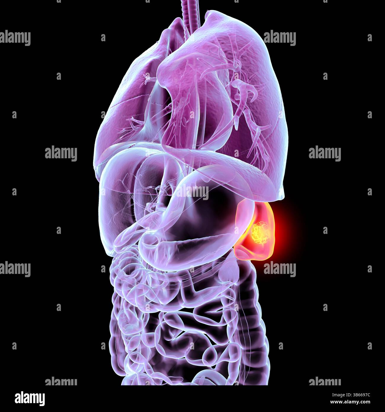 Illustration of spleen cancer, showing malignant growth in the spleen ...