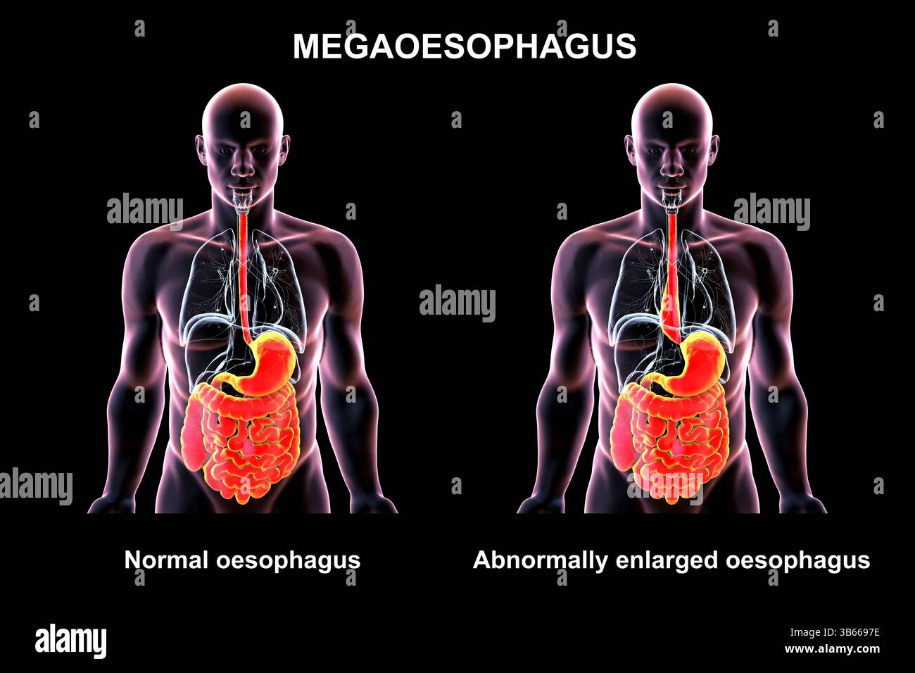 Illustration of megaoesophagus, a condition where the oesophagus ...
