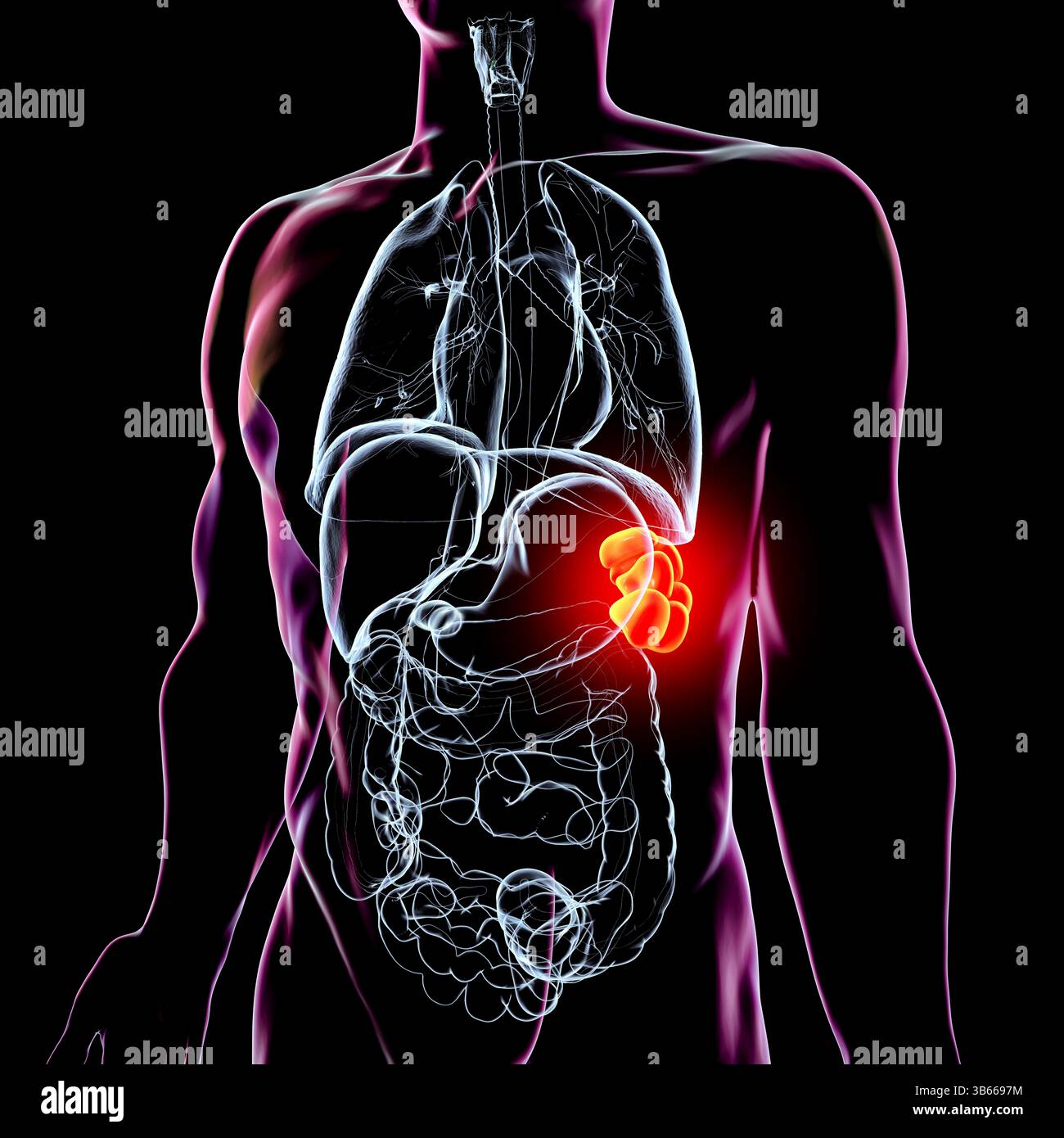 Illustration of polysplenia, a congenital condition characterised by ...