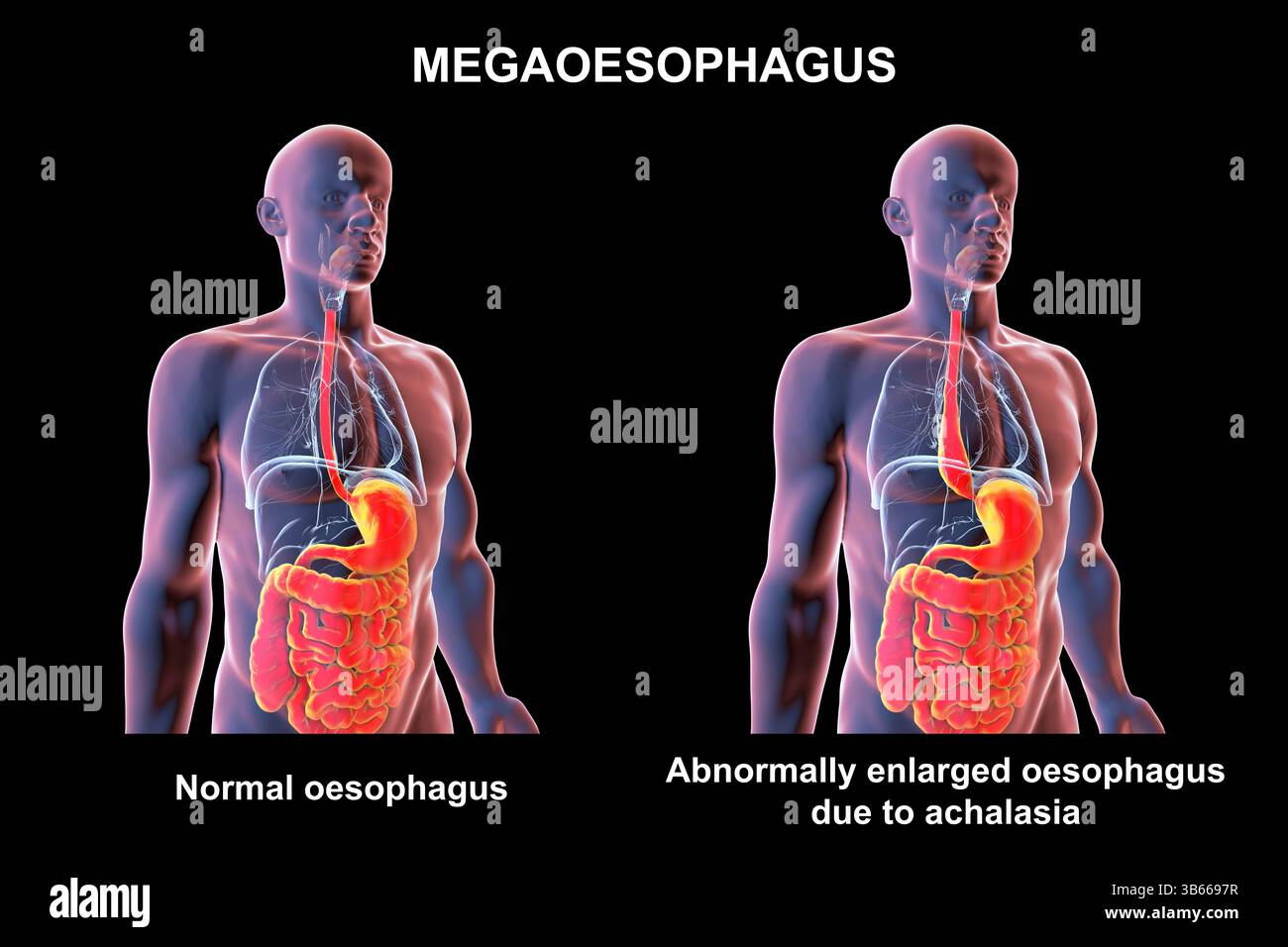 Illustration of megaoesophagus, a condition where the oesophagus ...