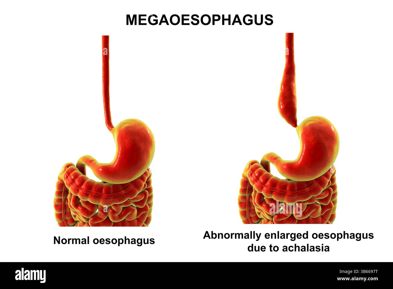 Illustration of megaoesophagus, a condition where the oesophagus ...