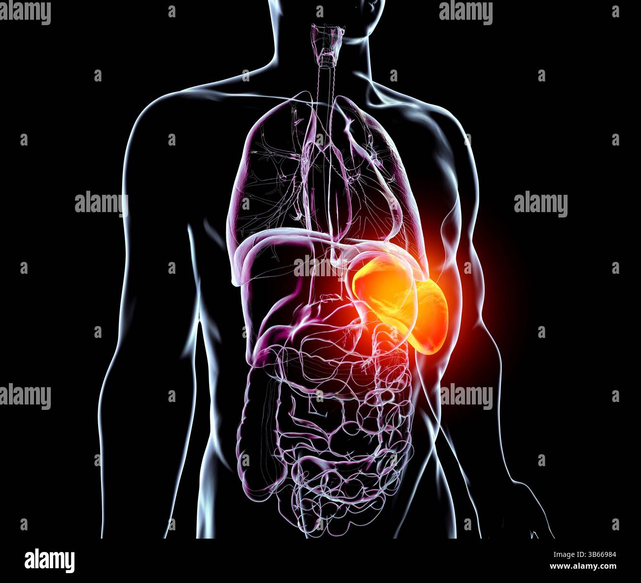 Illustration of a splenomegaly, showing an enlarged spleen. This occurs ...