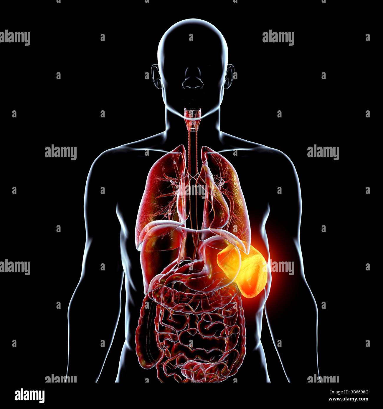 Illustration of a splenomegaly, showing an enlarged spleen. This occurs ...