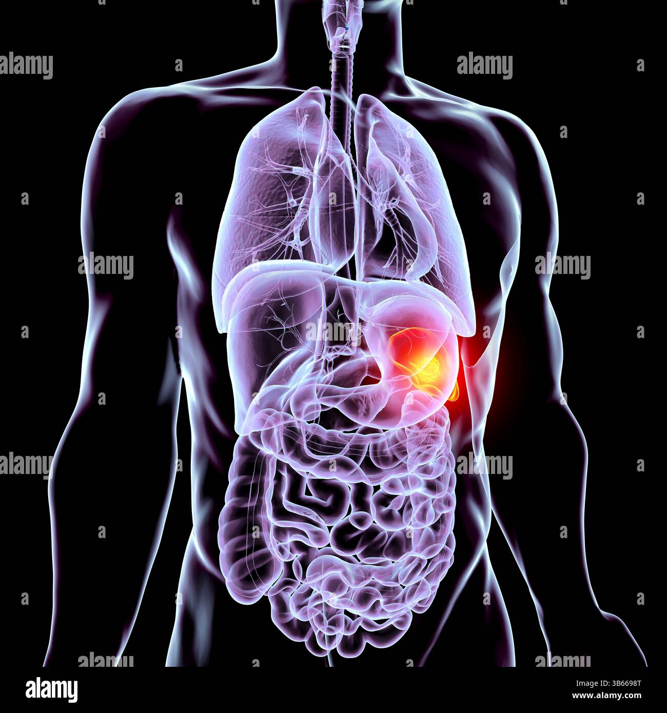 Illustration of spleen cancer, showing malignant growth in the spleen ...