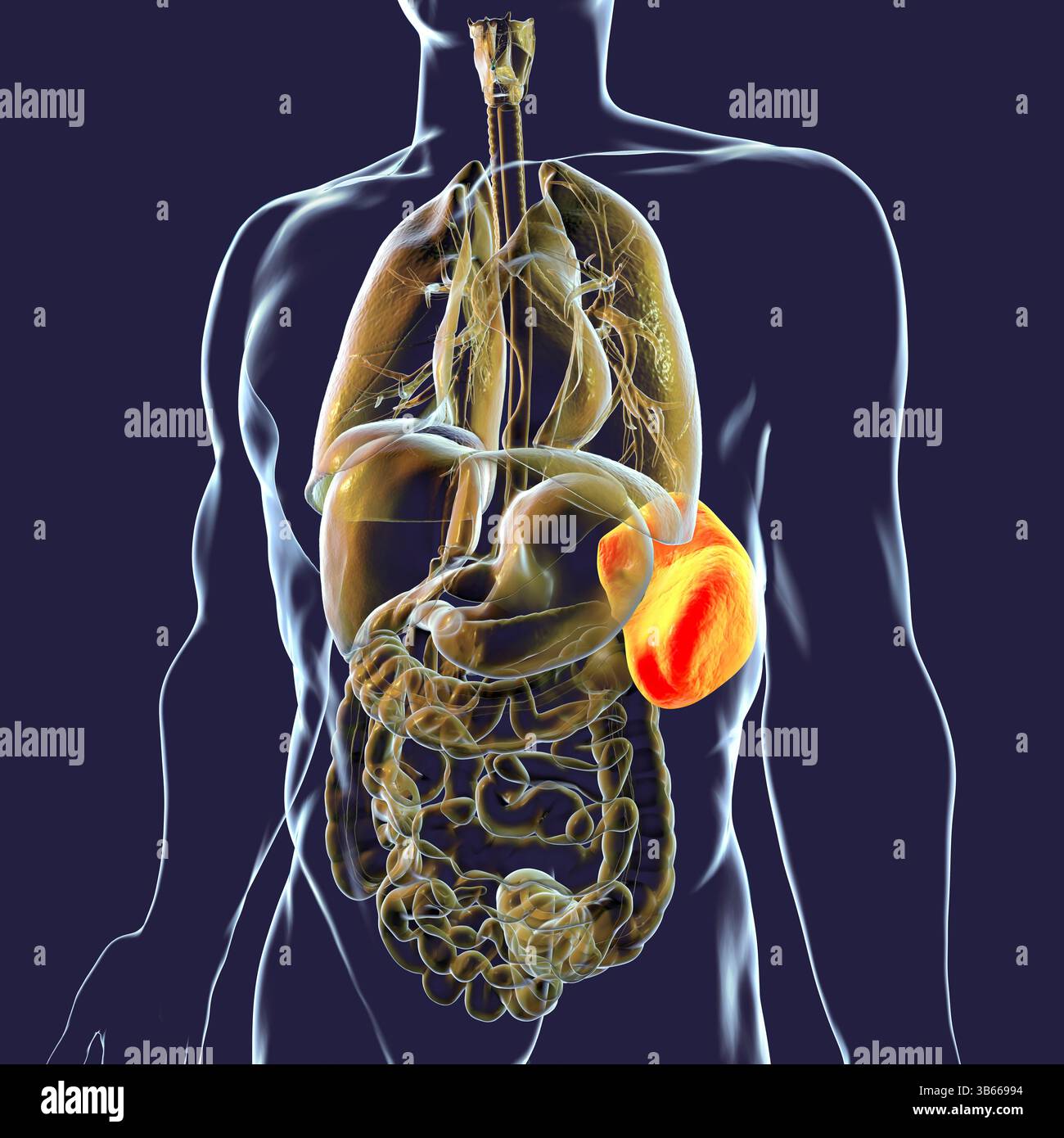 Illustration of a splenomegaly, showing an enlarged spleen. This occurs ...