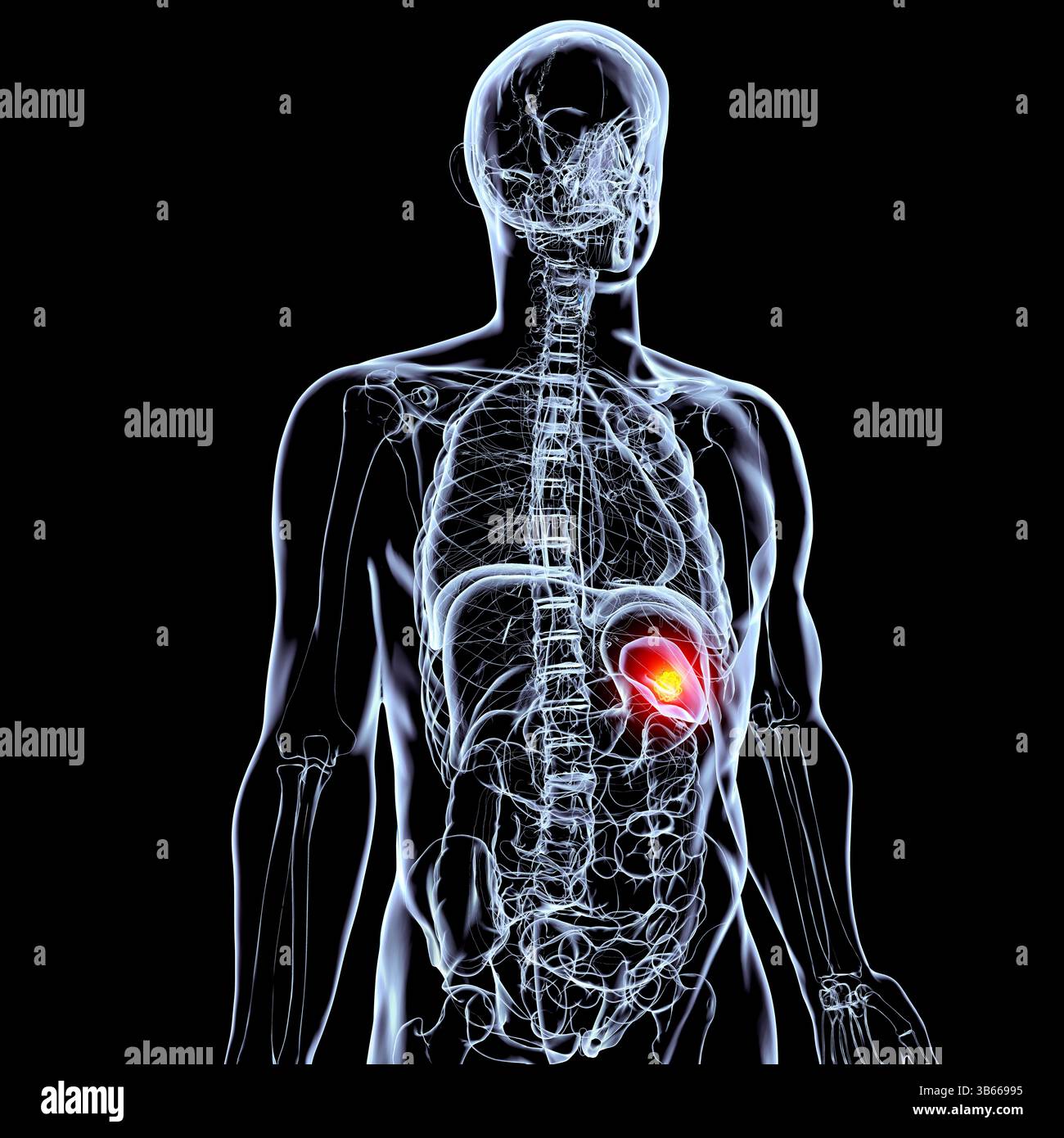 Illustration of spleen cancer, showing malignant growth in the spleen ...