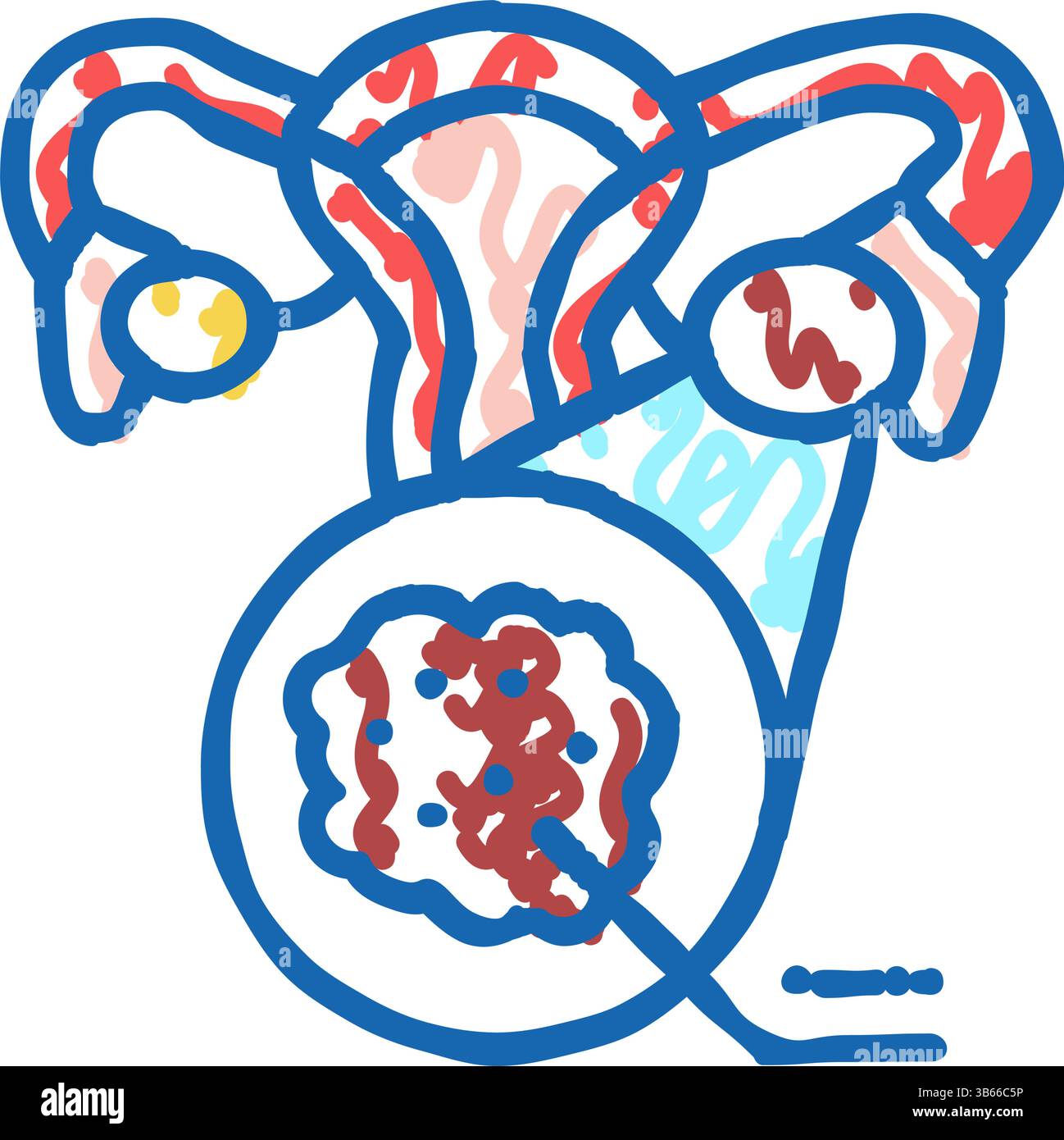 polycystic ovary syndrome endocrinology icon doodle illustration Stock ...