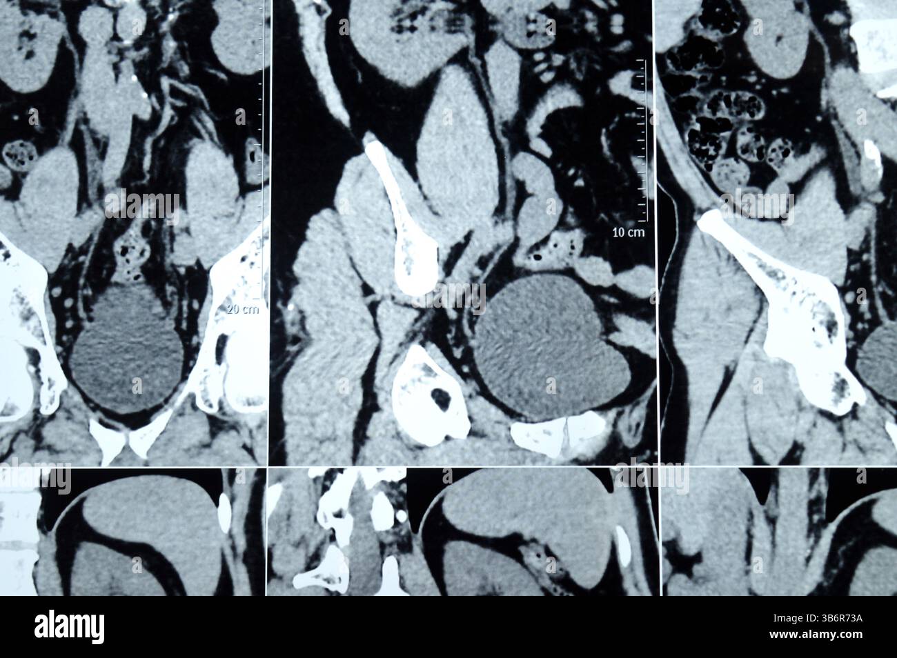 CT scan of abdomen and pelvis shows left upper ureteric stone with mild ...