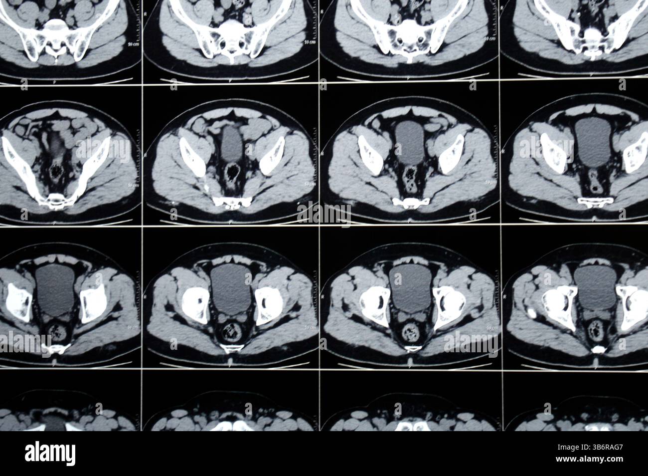 CT scan of abdomen and pelvis shows left upper ureteric stone with mild ...