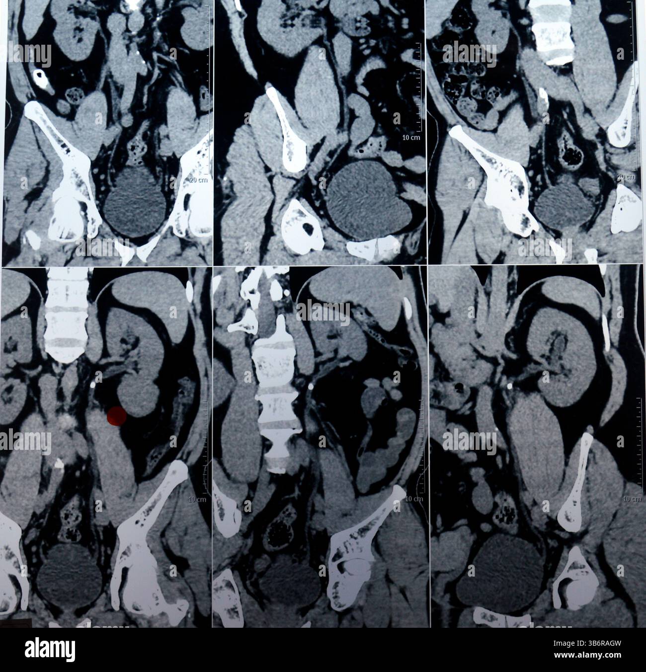 CT scan of abdomen and pelvis shows left upper ureteric stone with mild ...