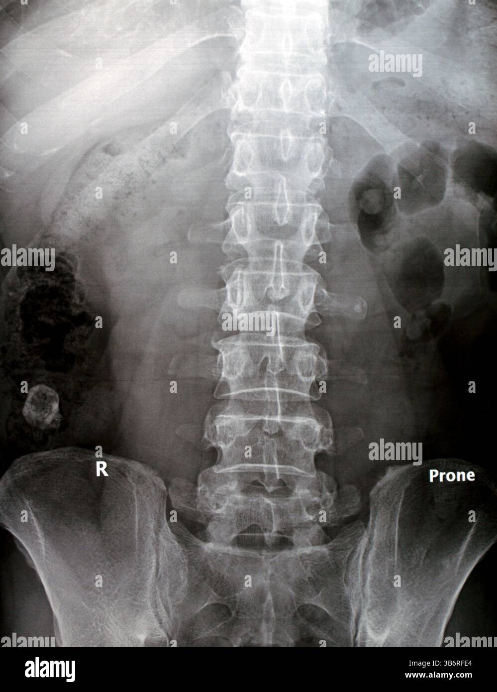 Digital computed radiography of the urinary tract shows small opaque ...
