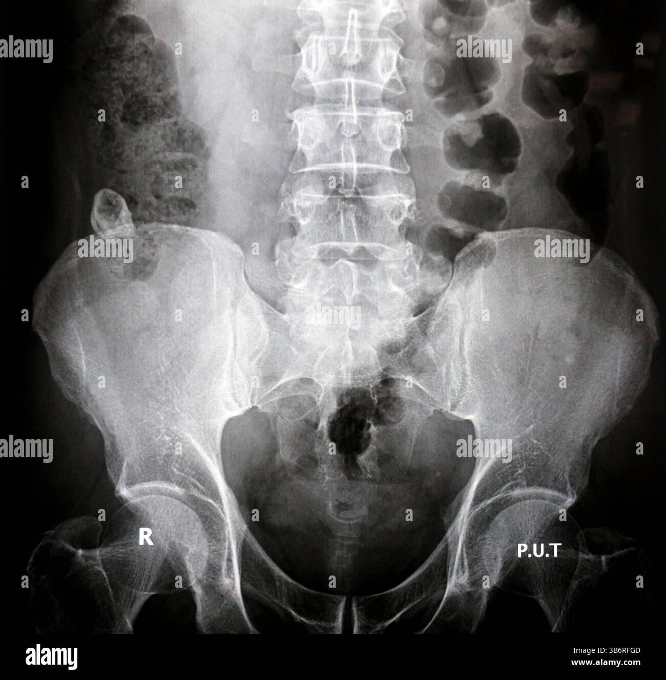 Digital computed radiography of the urinary tract shows small opaque ...