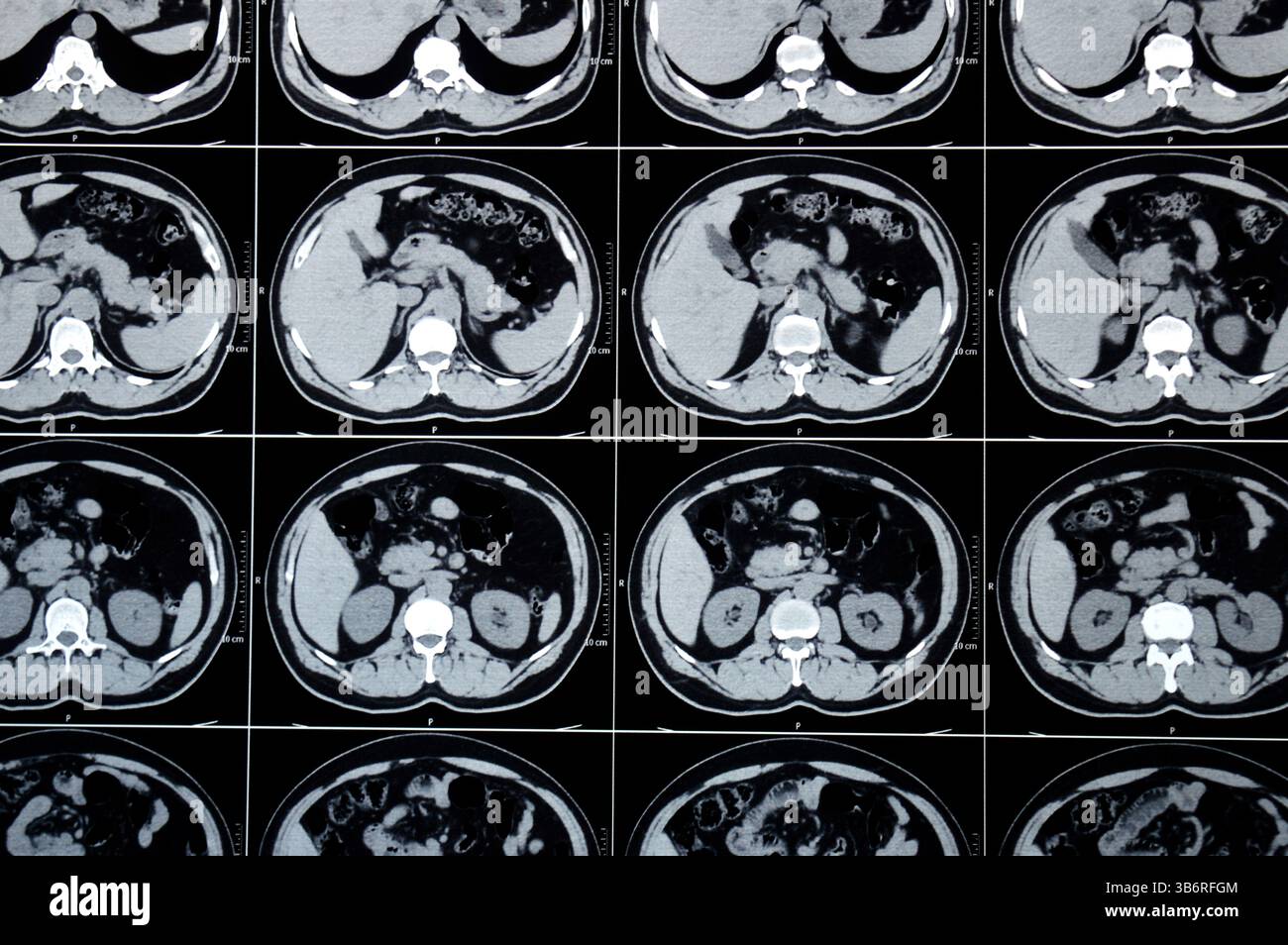 CT scan of abdomen and pelvis shows left upper ureteric stone with mild ...