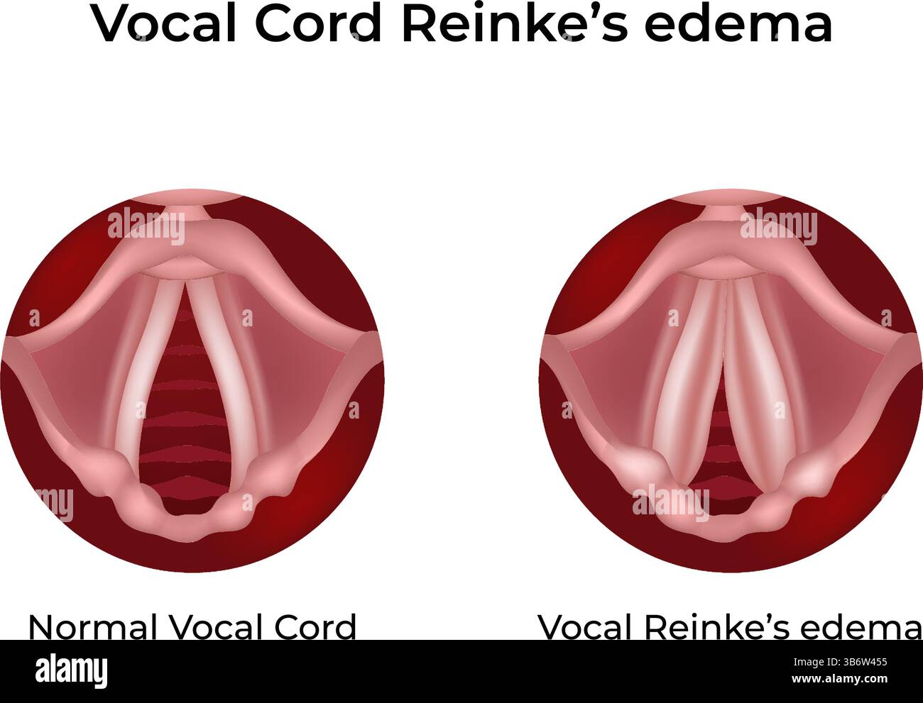 Vocal cords diagram hi-res stock photography and images - Alamy