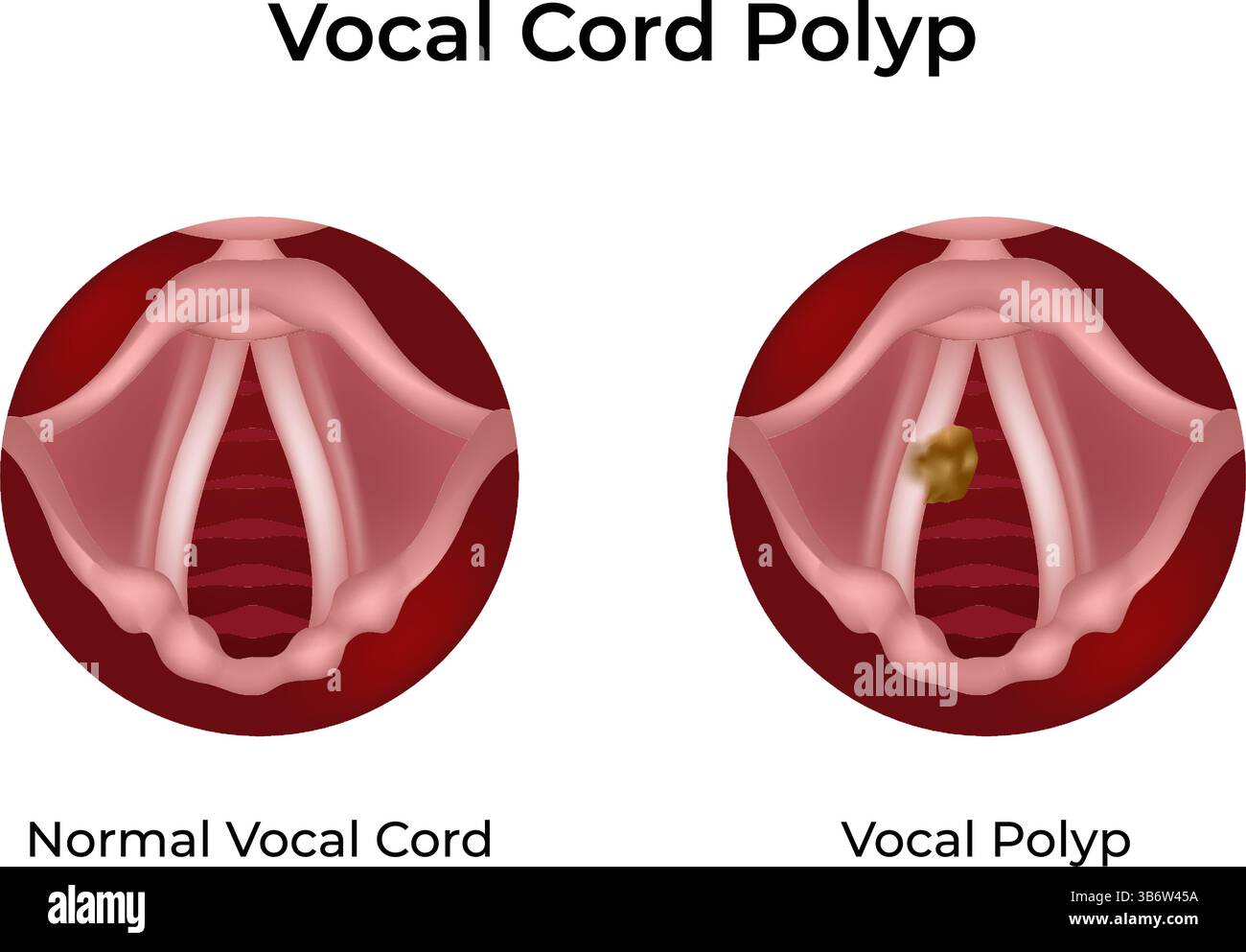 Vocal Cord Polyp vs Normal Vocal Cord Design Vector Illustration Stock ...