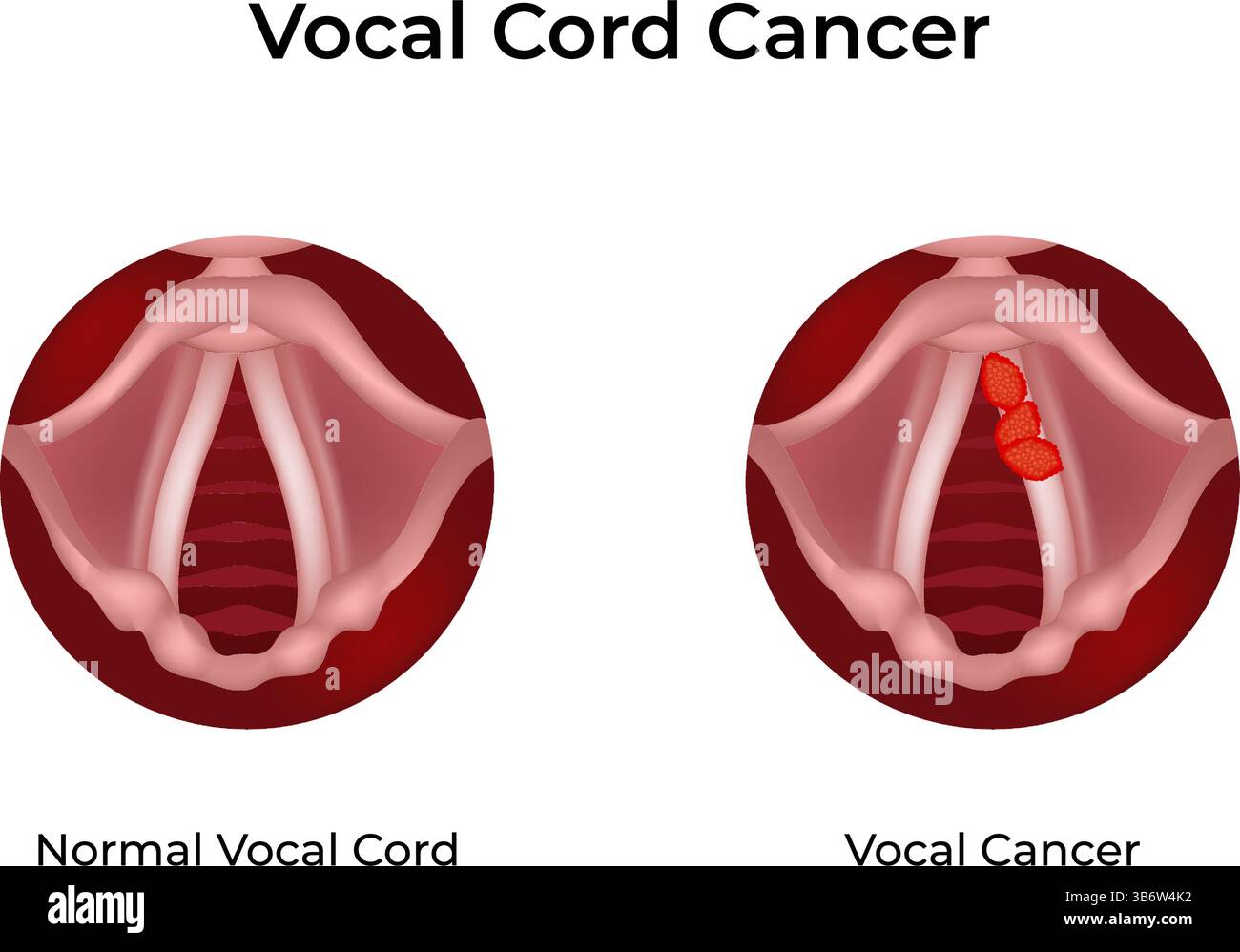 Vocal Cord Cancer Design Vector Illustration Stock Vector Image & Art - Alamy