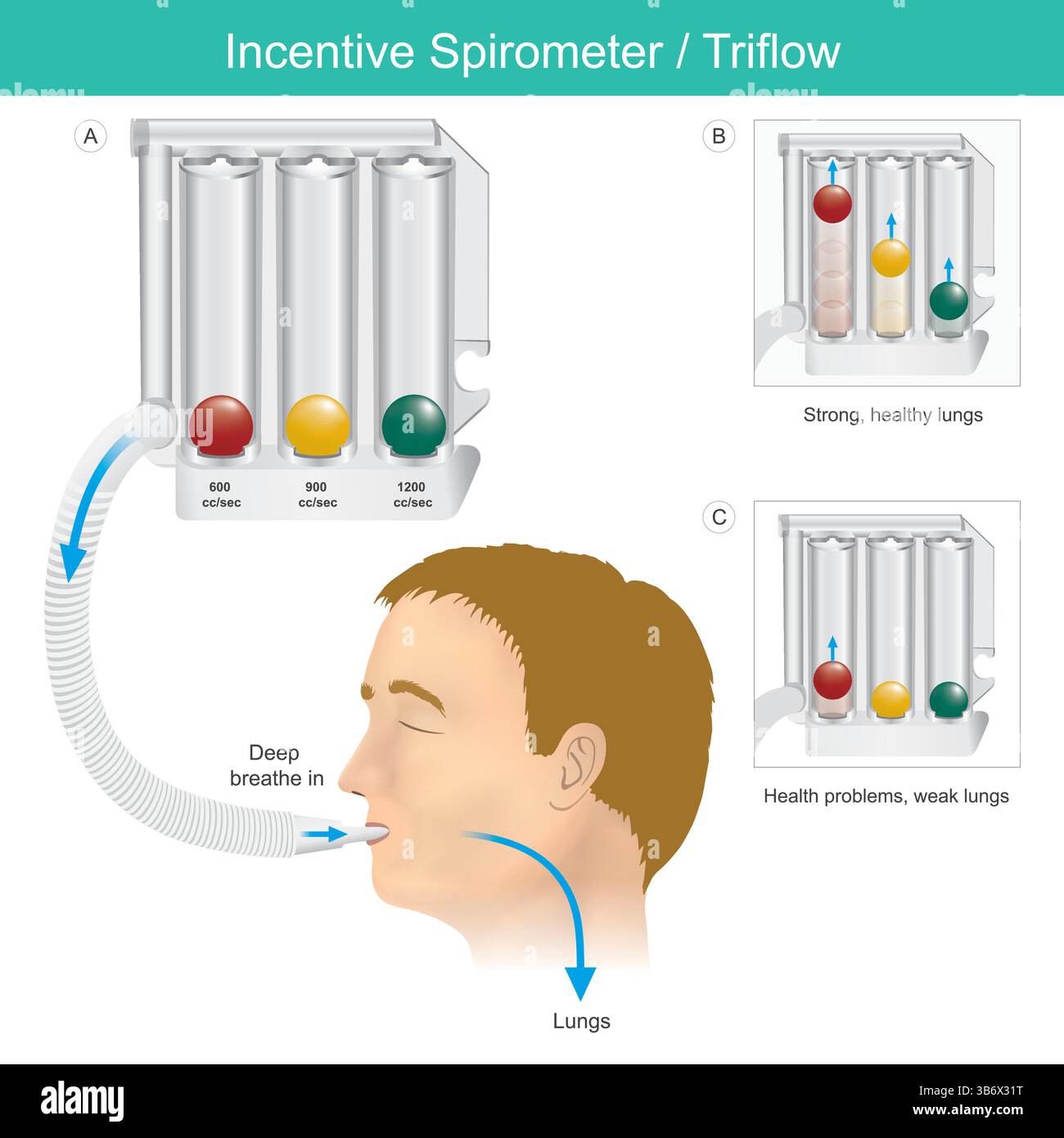 Incentive Spirometer. Triflow Lung Exercise Device Illustration Stock ...