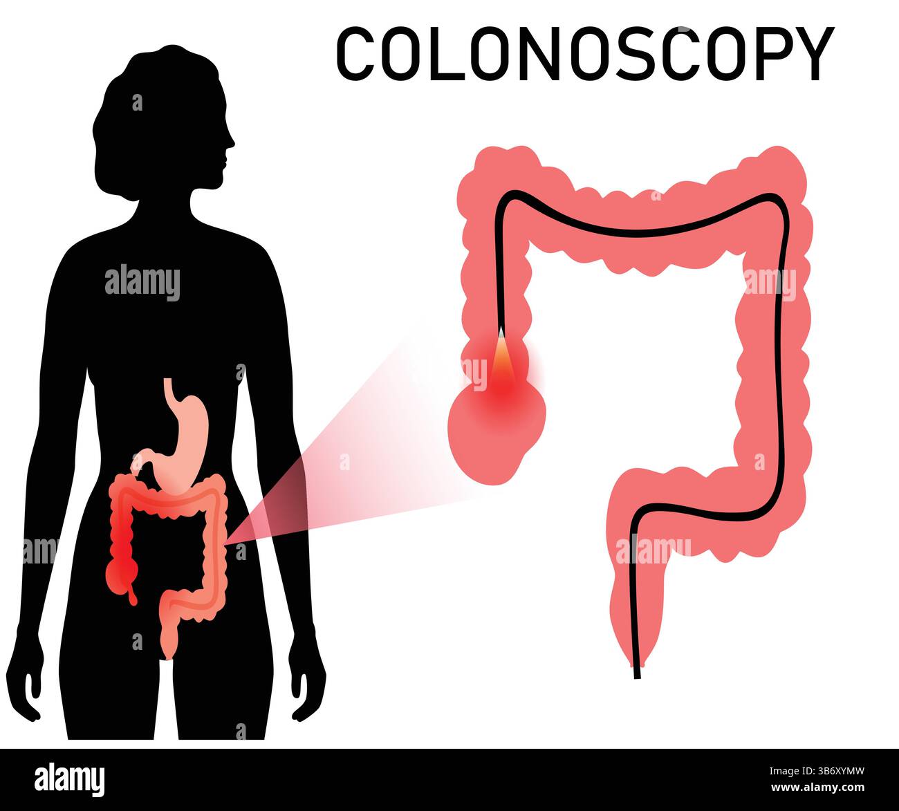 Colonoscopy Procedure Medical Vector – Digestive System Examination and ...
