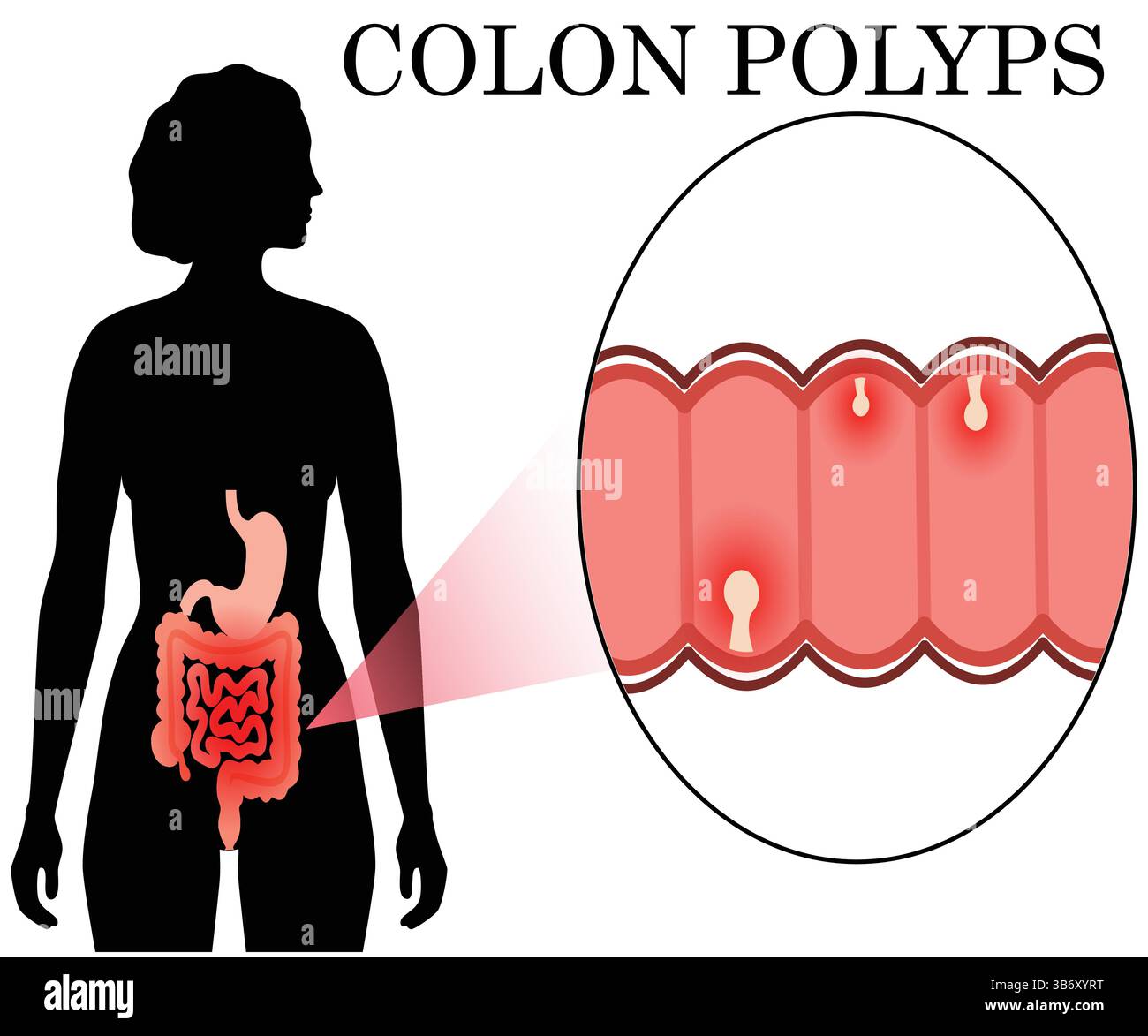 Colon Polyps Medical Illustration – Digestive System Disease and ...