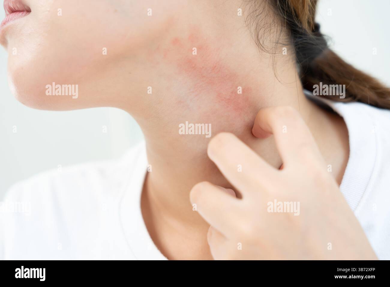 Skin and beauty problems: Women have itchy skin and red rashes from ...