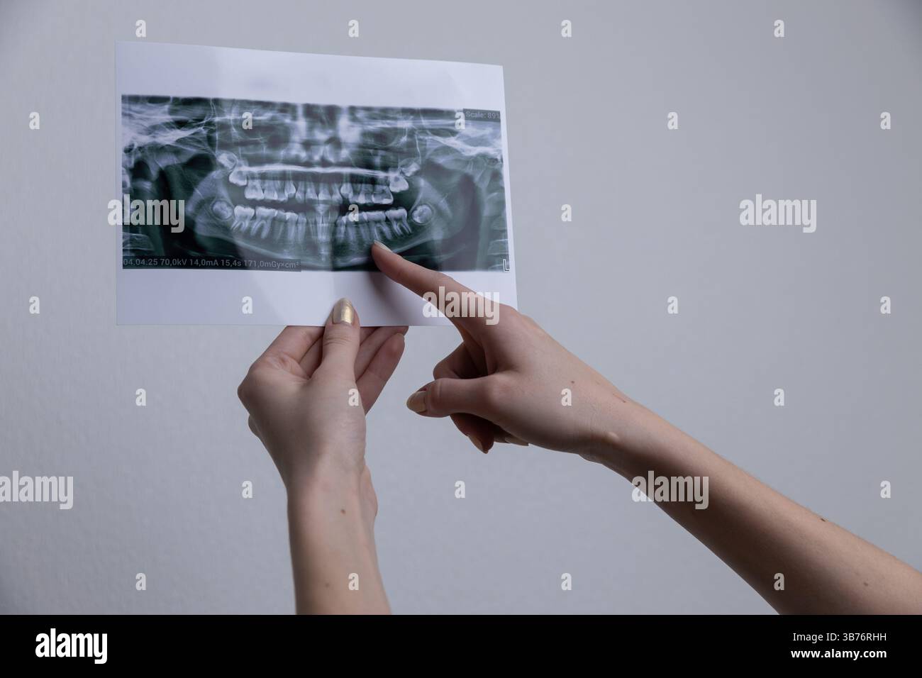 An individual is holding a dental X-ray, pointing at specific tooth ...