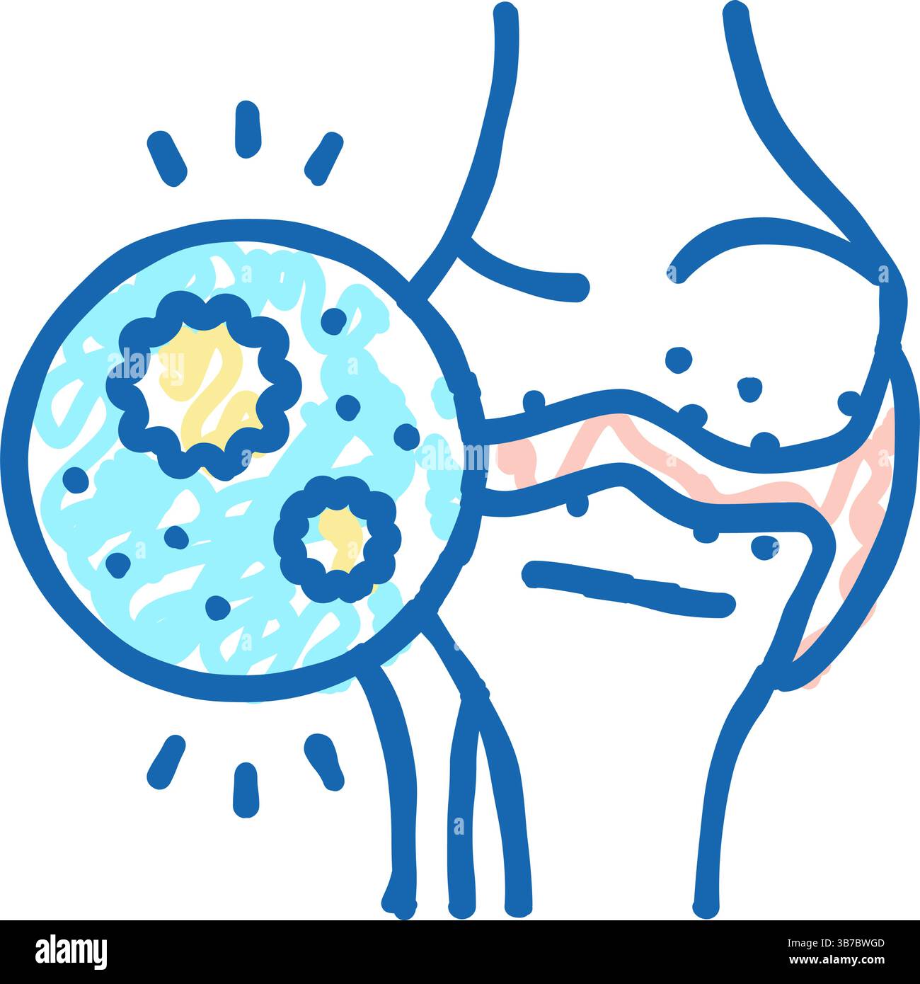 infectious arthritis icon doodle illustration Stock Vector Image & Art ...