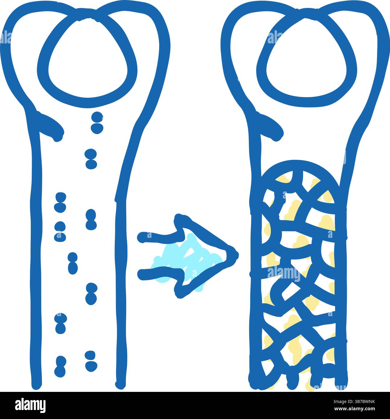 osteoporosis bone disease icon doodle illustration Stock Vector Image ...